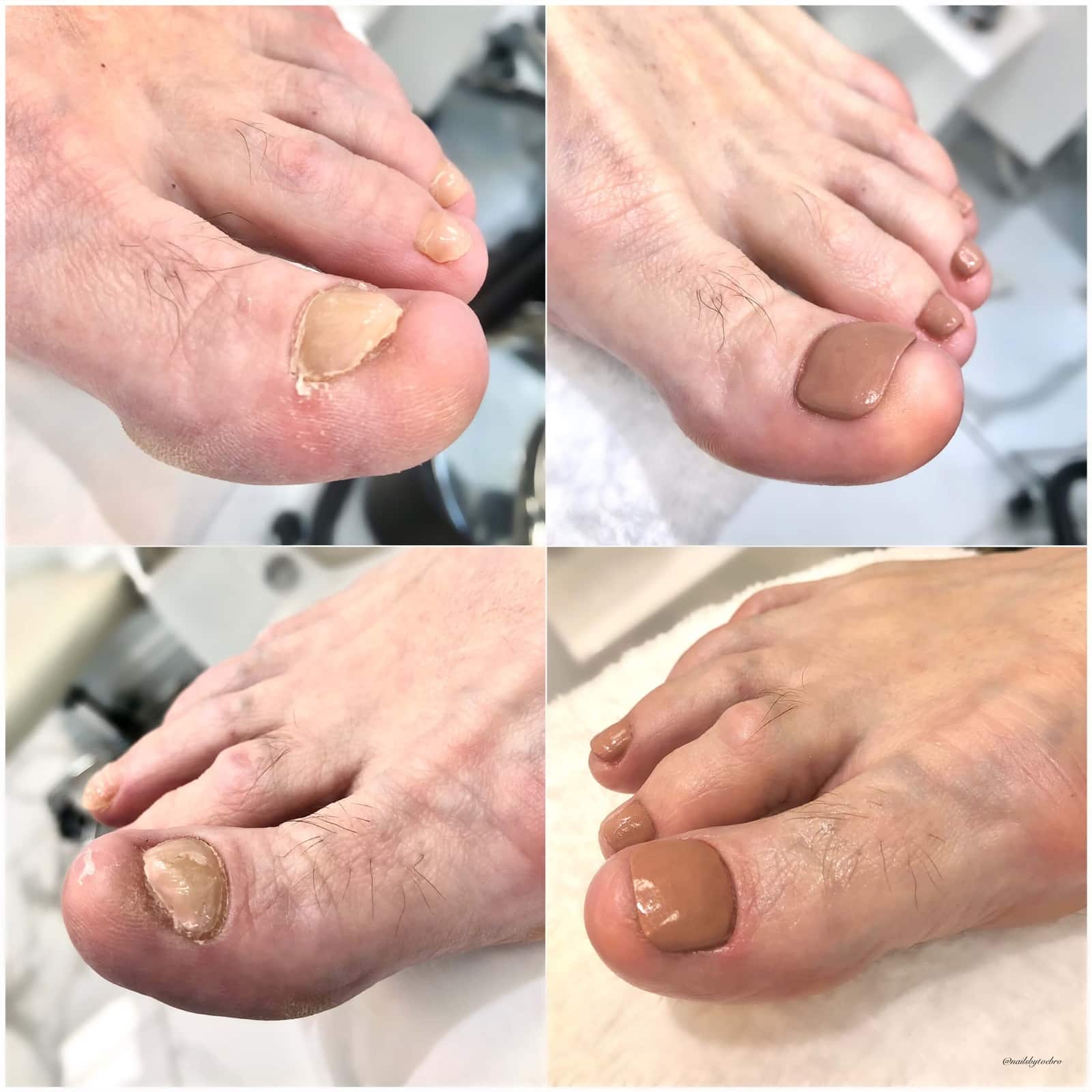 Nail Reconstruction Treatment | Nails by Toe Bro
