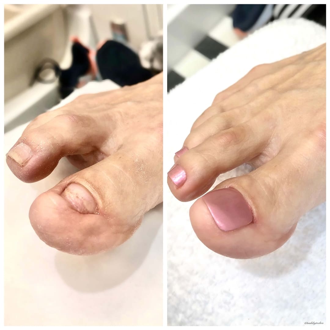 Nail Reconstruction Treatment | Nails by Toe Bro