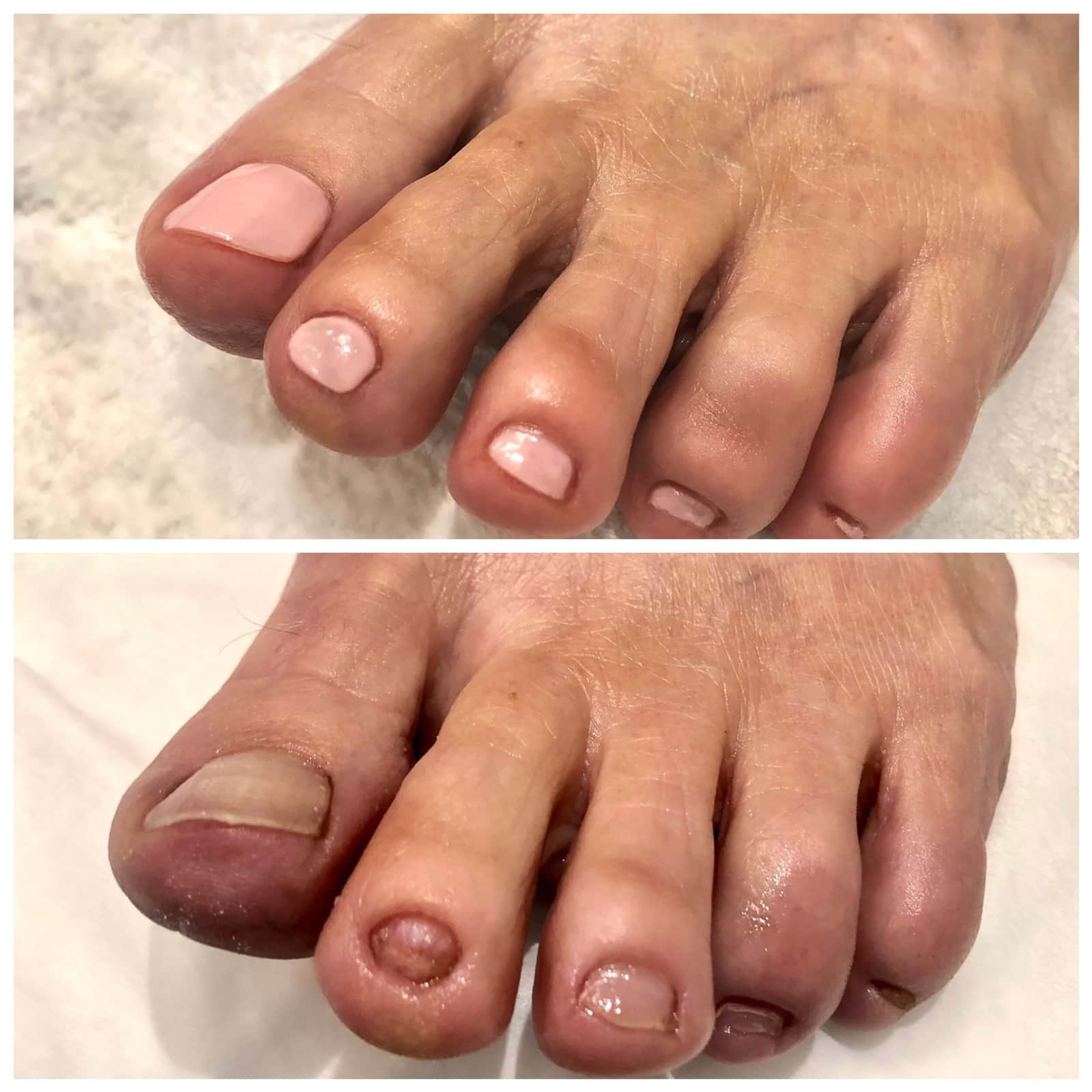 Nail Reconstruction Treatment | Nails by Toe Bro