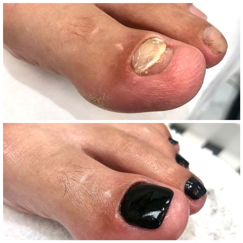 Nail Reconstruction Treatment | Nails by Toe Bro