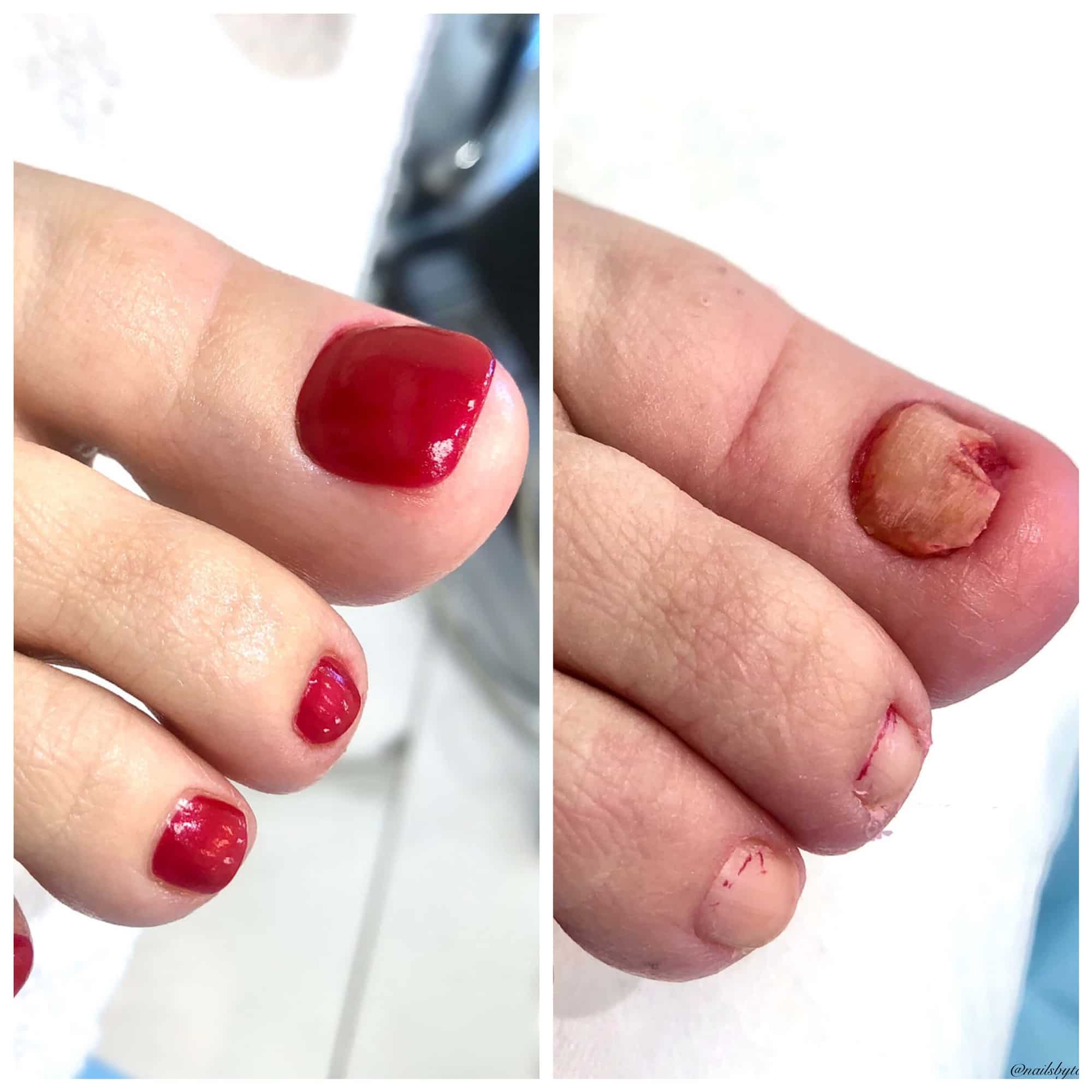 Nail Reconstruction Treatment | Nails by Toe Bro