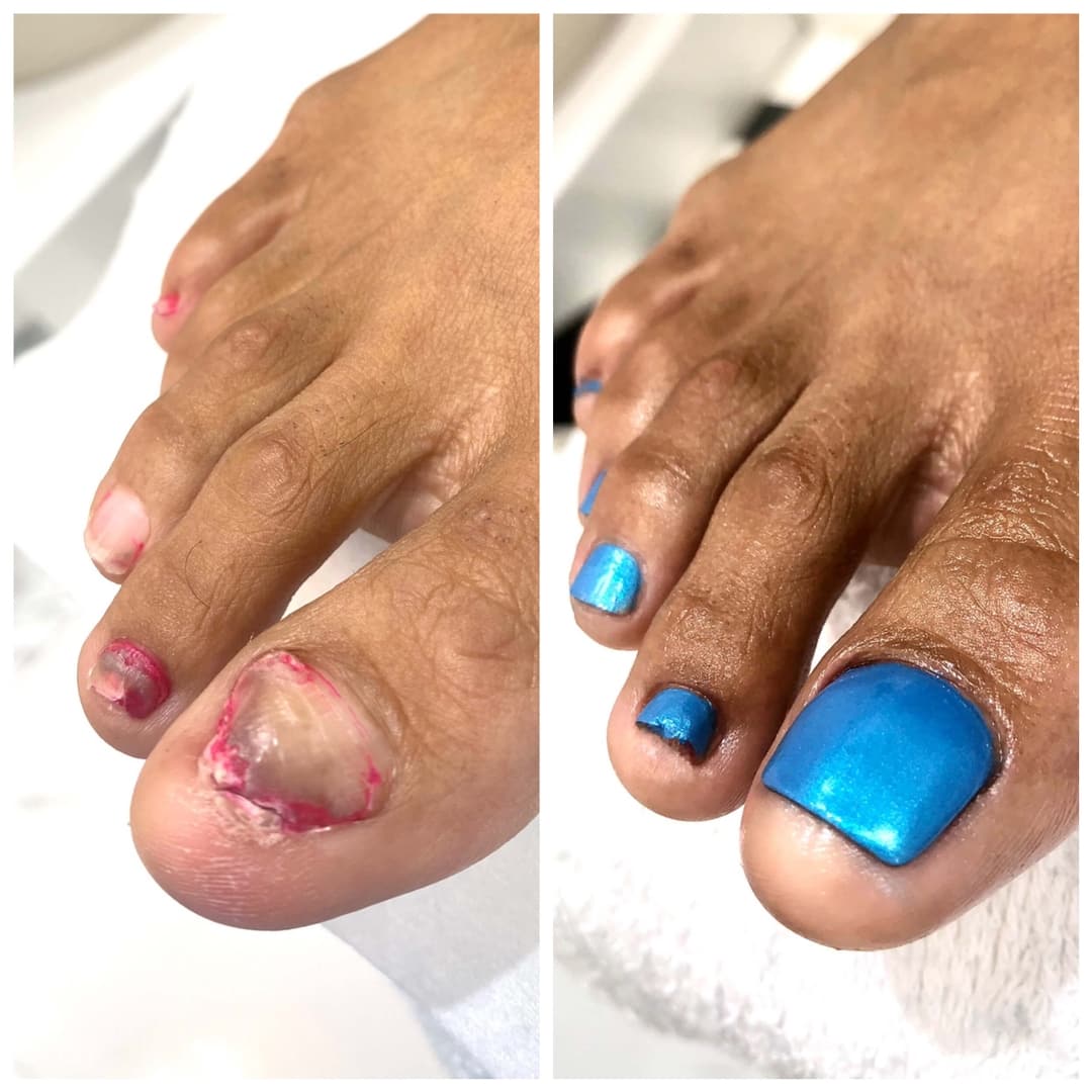 Nail Reconstruction Treatment | Nails by Toe Bro
