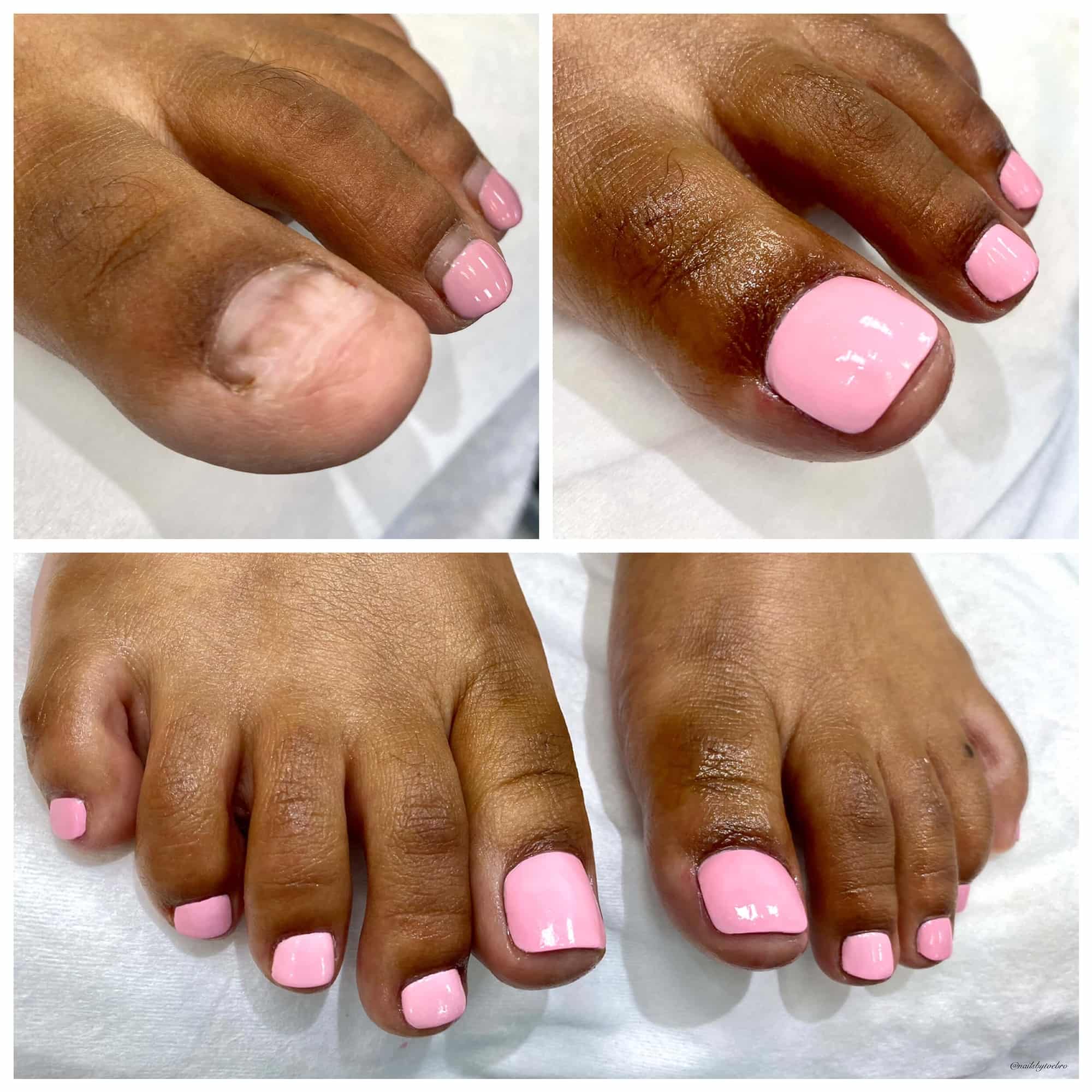 Nail Reconstruction Treatment | Nails by Toe Bro