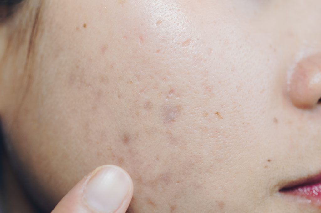 Melasma vs. Hyperpigmentation: Spotting the Difference - Strut Blog