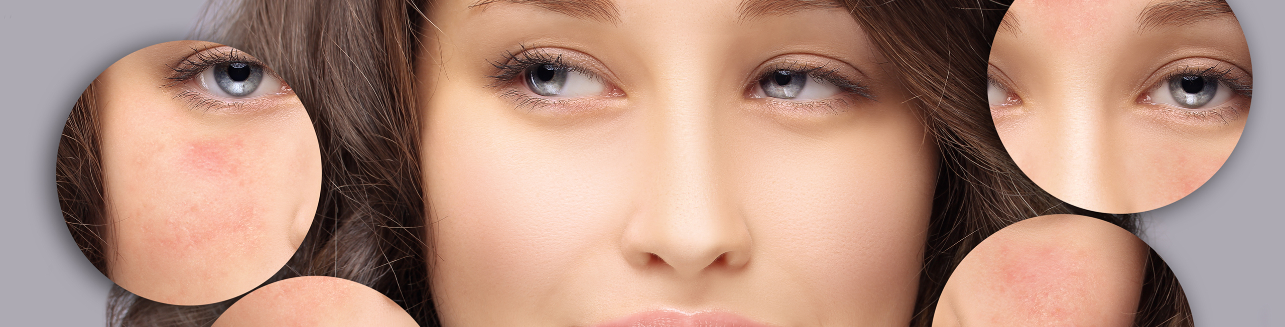 Rosacea Type 2 Treatment With Strut Rosacea Formula #2 For Acne Rosacea ...