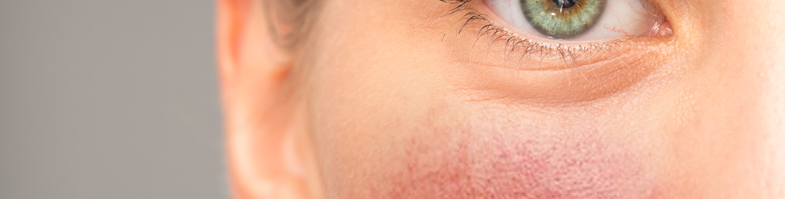 What Are The Most Common First Signs Of Rosacea? - Strut Blog