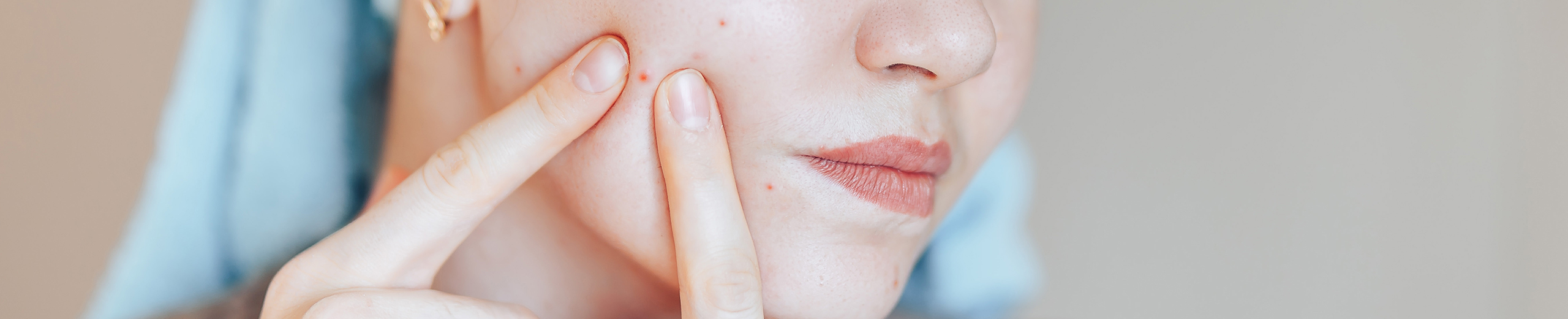 Is Popping a Pimple All That Bad? Read This Before You Pop Your Next ...