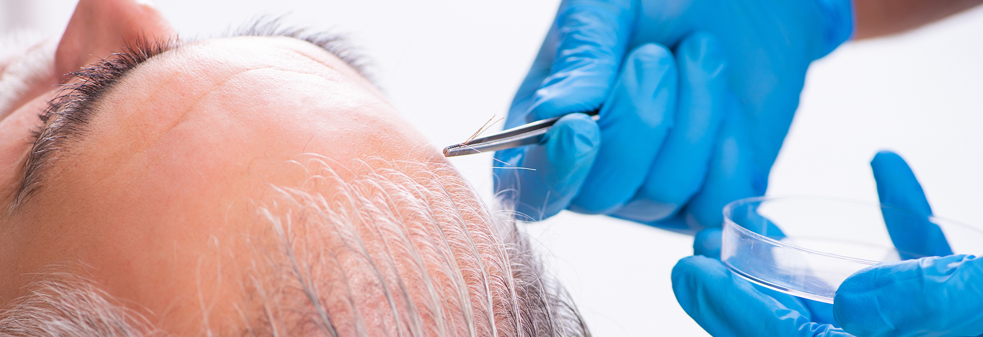 What Is Hair Cloning? What To Expect for Future Hair Loss Treatments ...