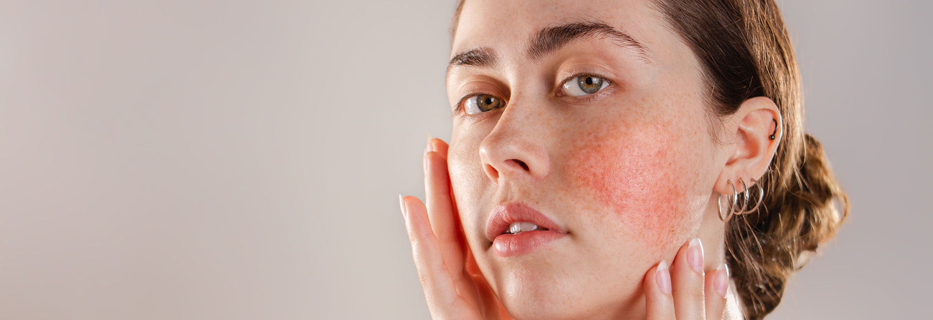 Is Rosacea Adult Acne? 6 Differences Between These Skin Conditions ...