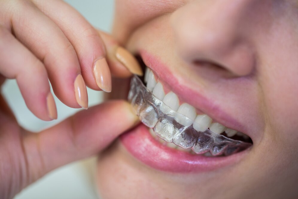 Embrace the Power of Invisalign: Guide