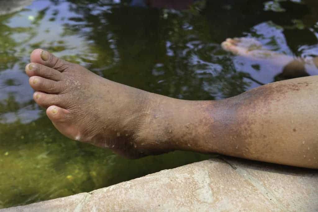 Vein Envy® - Top Rated Arizona Varicose Vein & Spider Vein Clinic