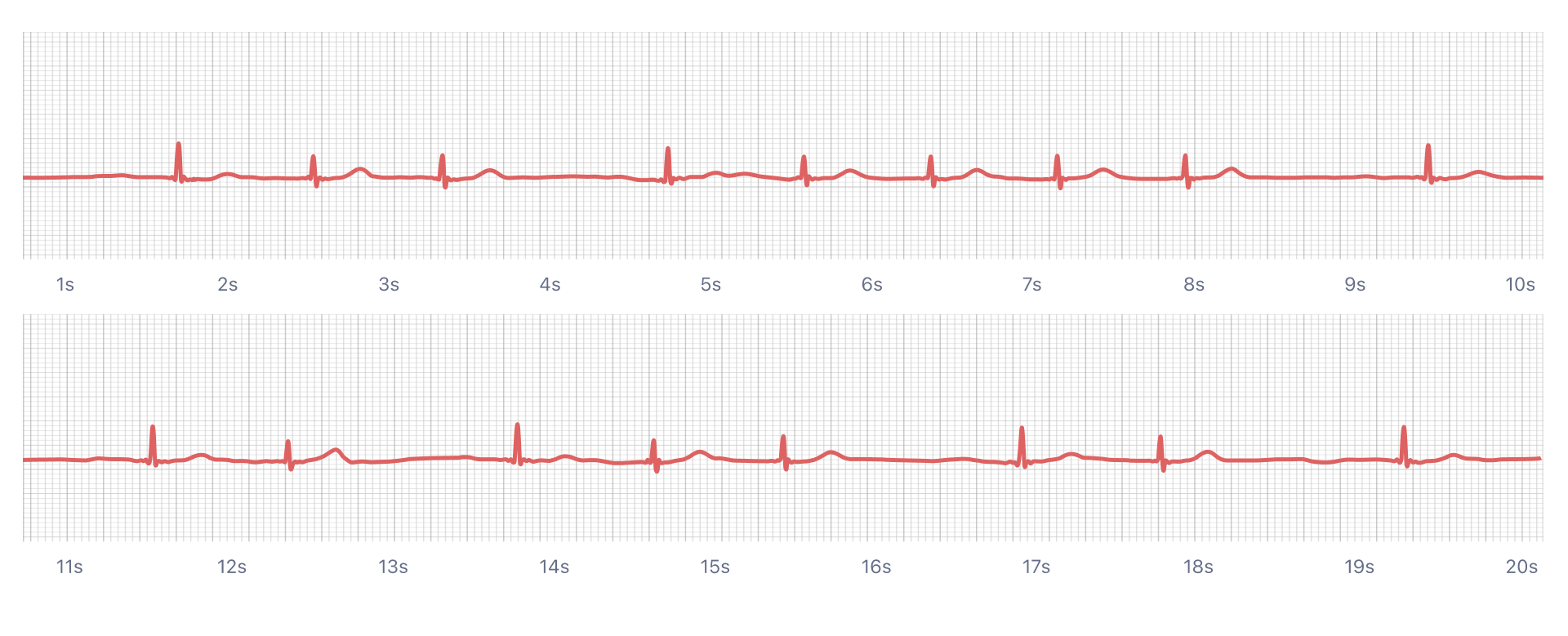 What Second-Degree AV Block Type 1 (Wenckebach) Looks Like on Your ...