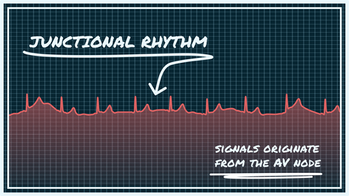 What Junctional Rhythm Looks Like on Your Watch ECG | Qaly