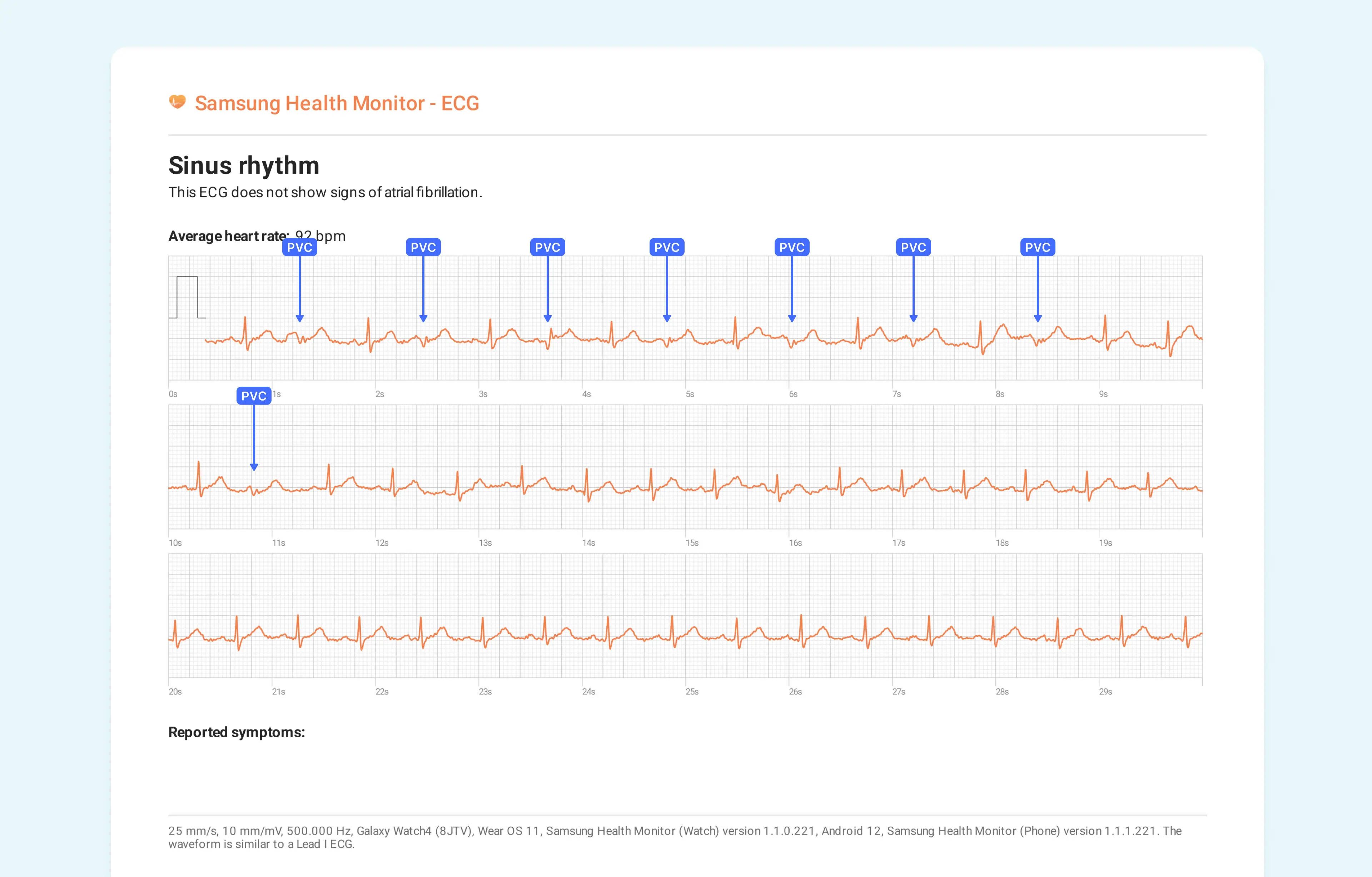 What Ventricular Bigeminy Looks Like on Your Watch ECG | Qaly