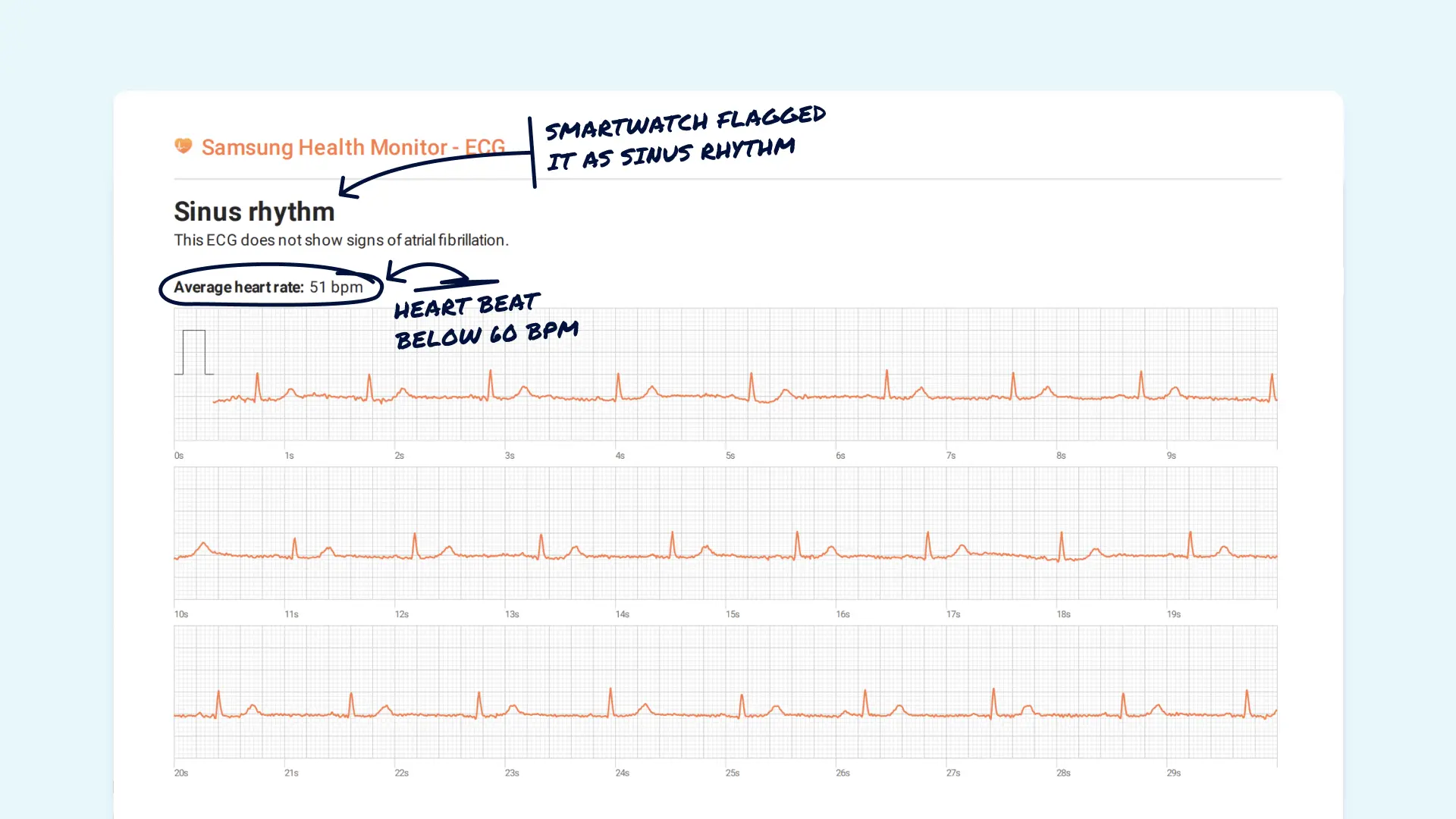 What Sinus Bradycardia Looks Like on Your Watch ECG | Qaly