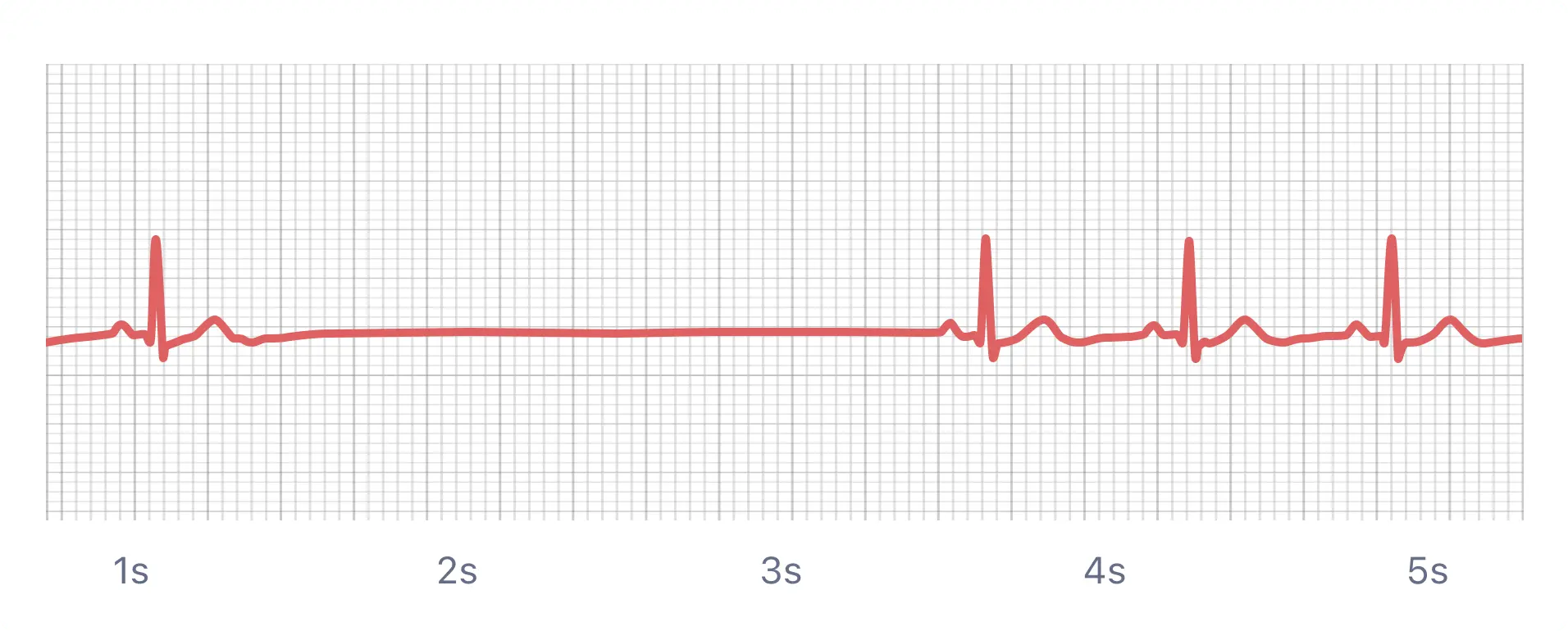 What Sinus Pause >3 Seconds Looks Like on Your Watch ECG | Qaly