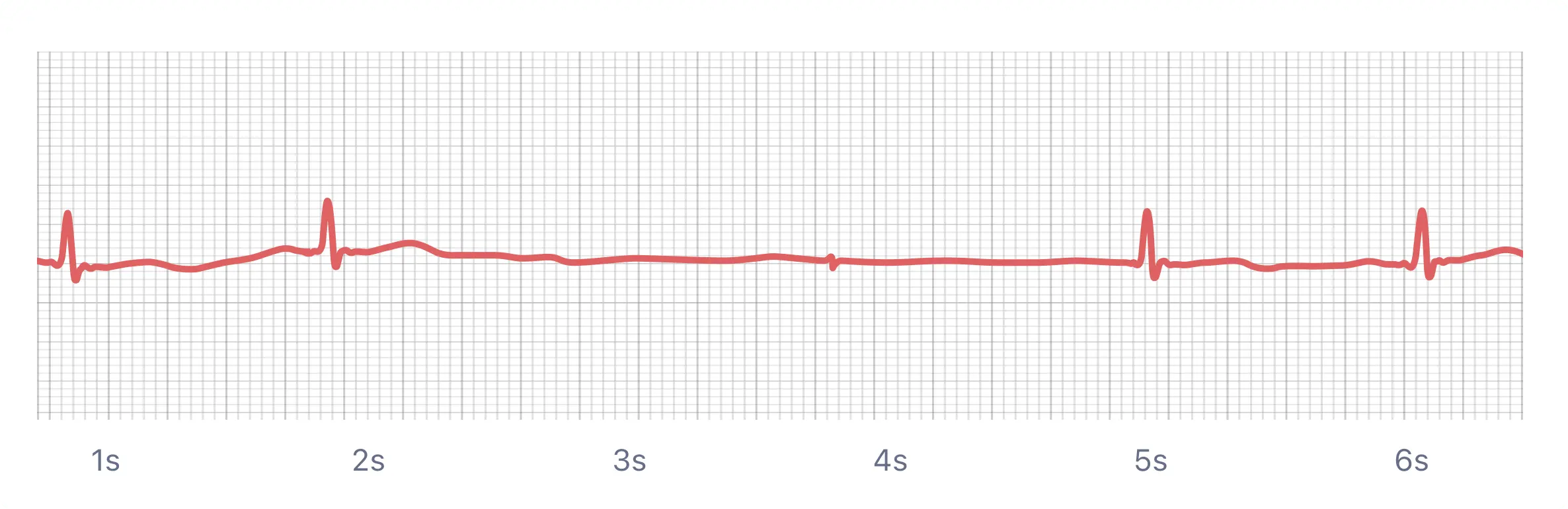 What Sinus Pause >3 Seconds Looks Like on Your Watch ECG | Qaly