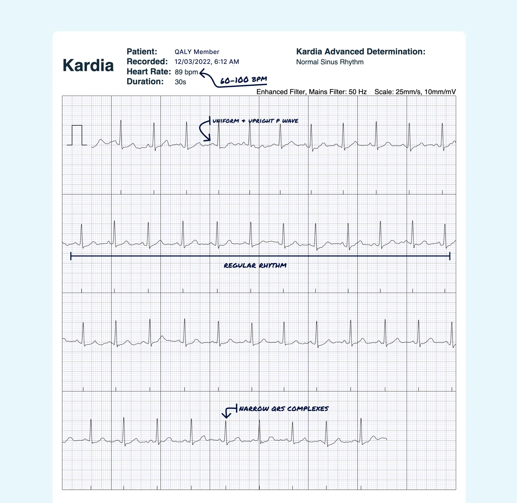 Sinus Rhythm Vs. Sinus Arrhythmia on Your Watch ECG | Qaly