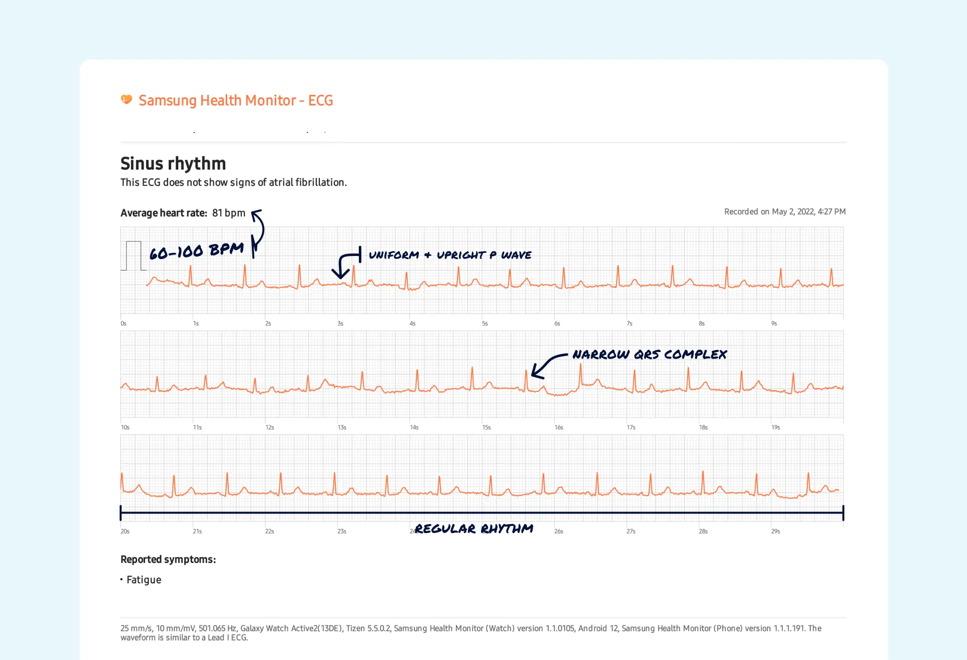 Sinus Rhythm Vs. Premature Atrial Contraction (Multiple) on Your Watch ECG | Qaly