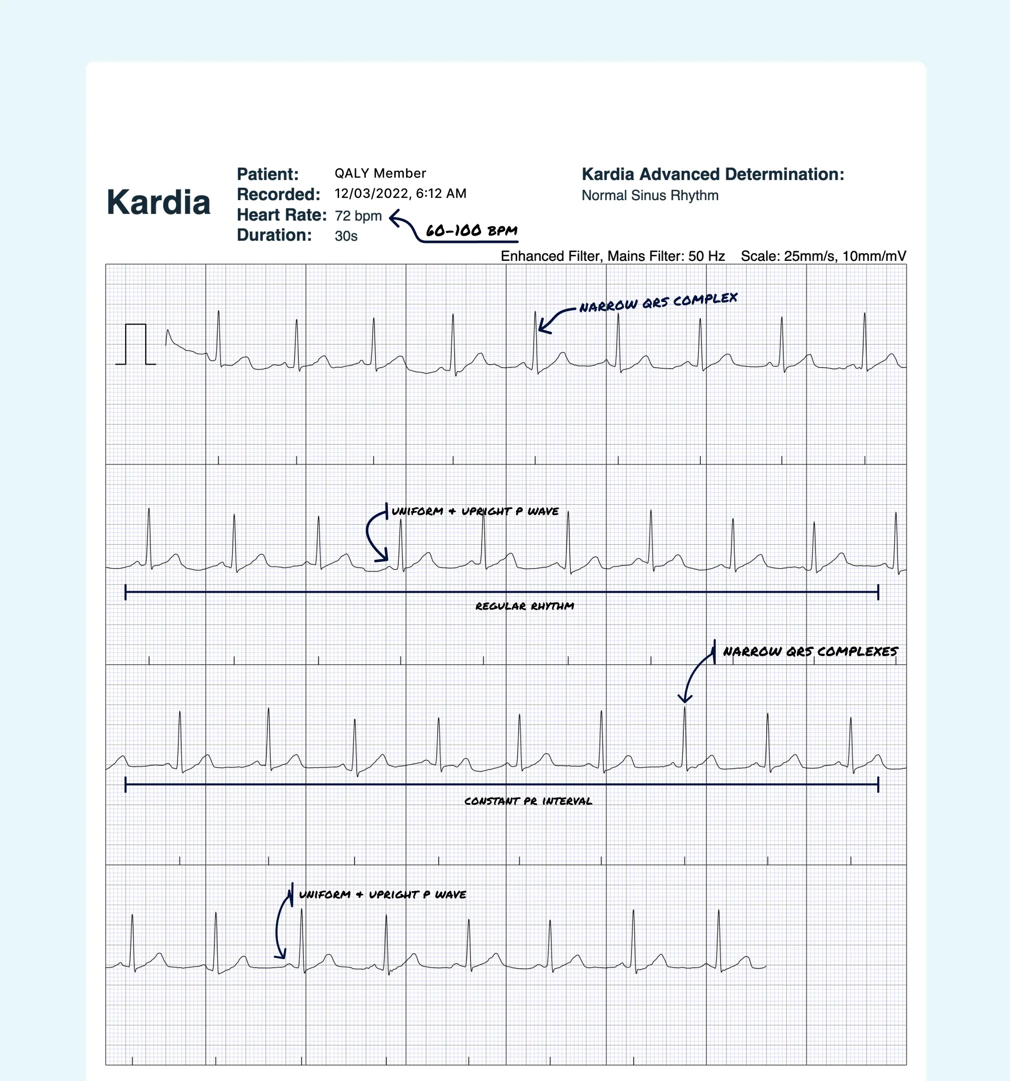 Sinus Rhythm Vs. Sinus Tachycardia on Your Watch ECG | Qaly