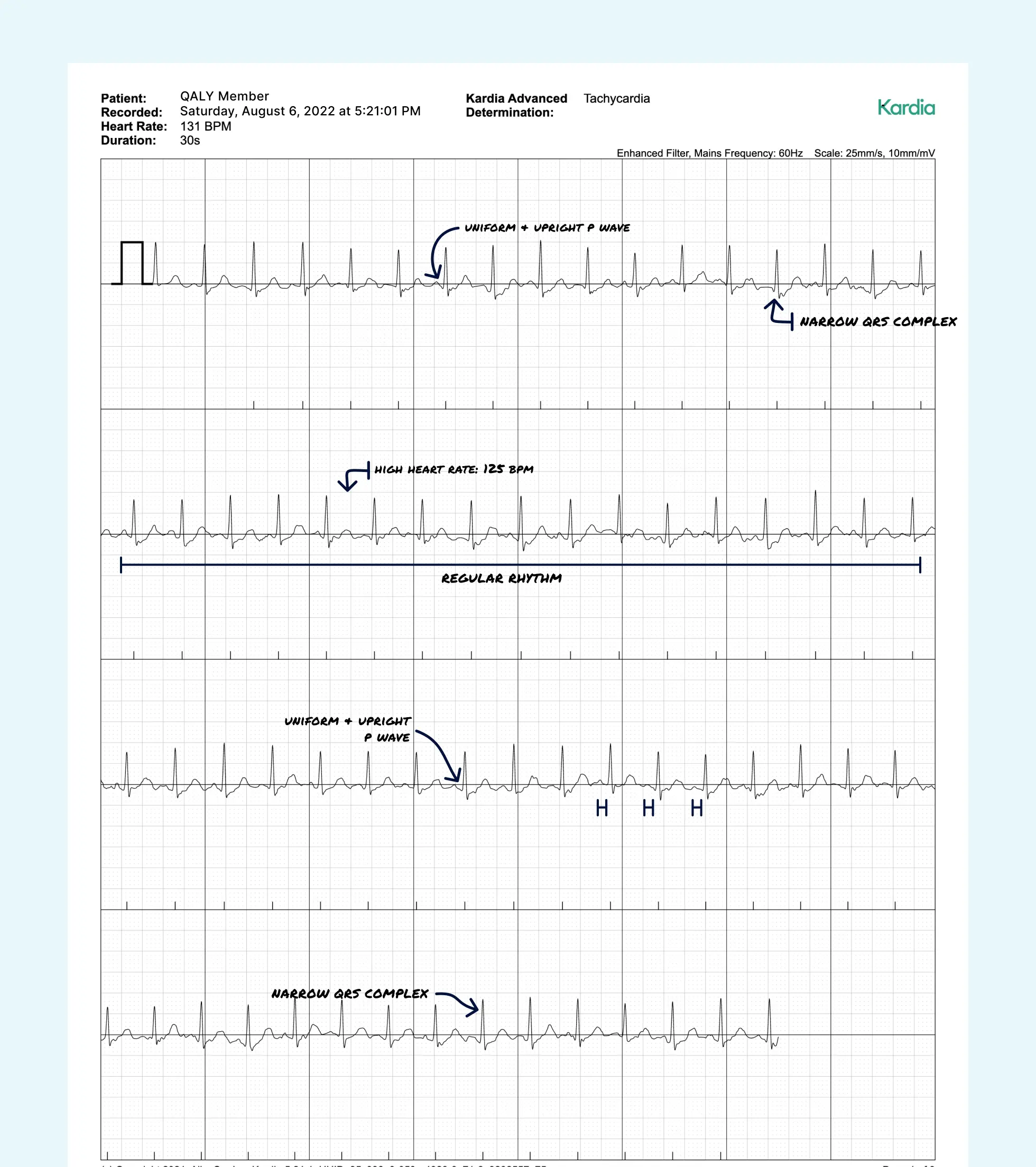 Sinus Rhythm Vs. Sinus Tachycardia on Your Watch ECG | Qaly