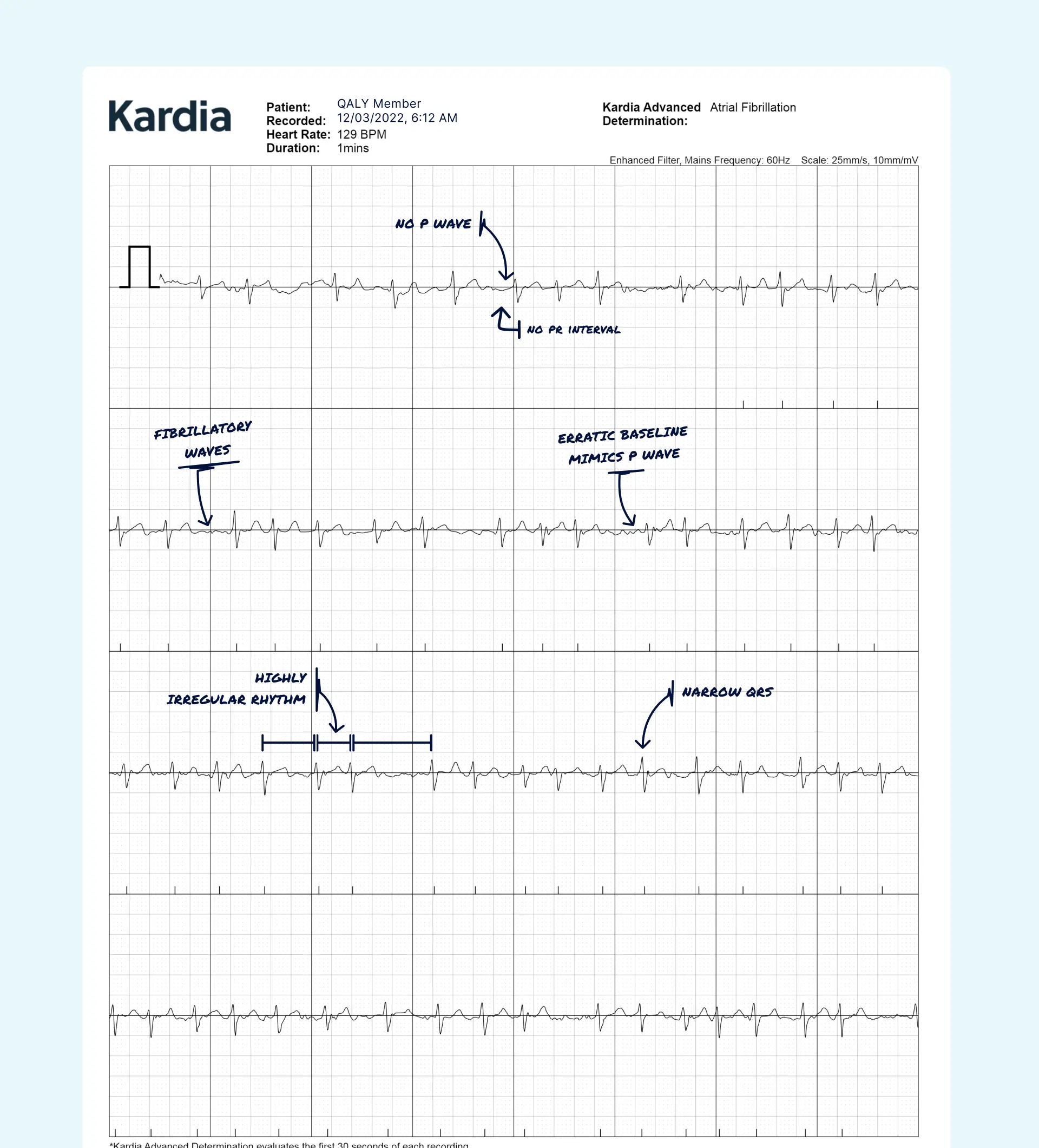 Supraventricular Tachycardia (Non-Sustained) Vs. Atrial Fibrillation on ...
