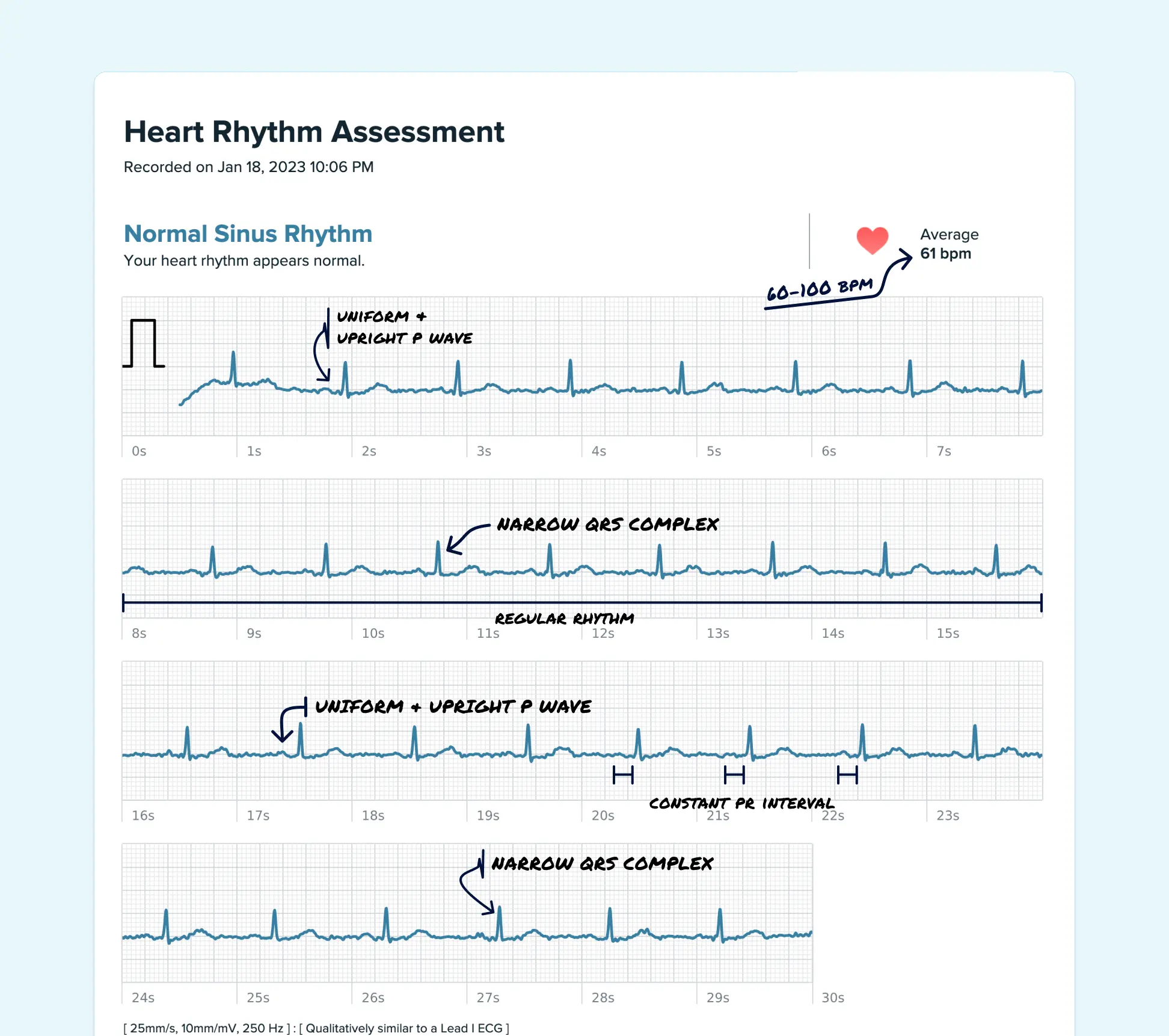 Sinus Rhythm Vs. Sinus Bradycardia on Your Watch ECG | Qaly