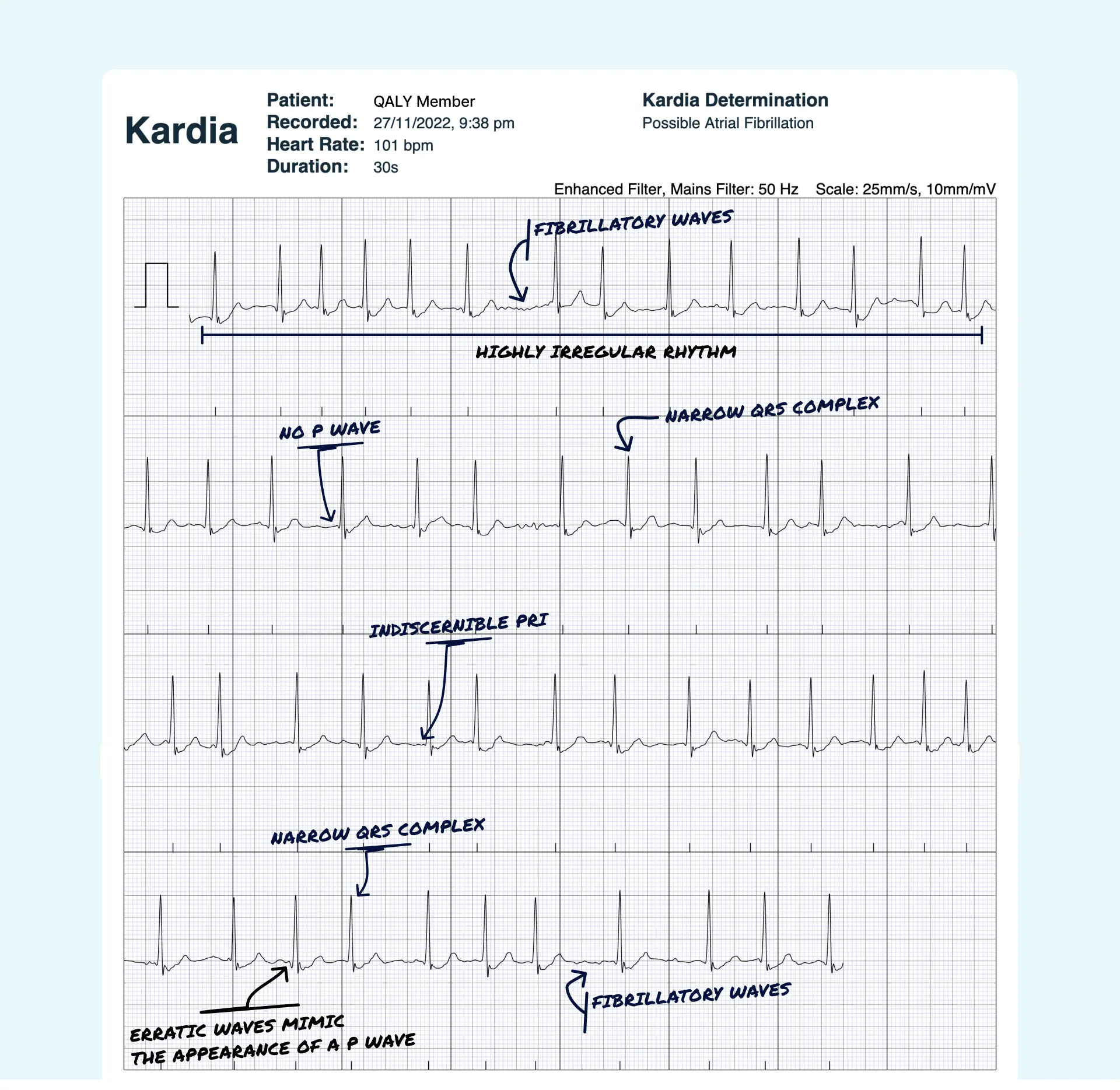 Premature Atrial Contraction (Single) Vs. Atrial Fibrillation on Your ...