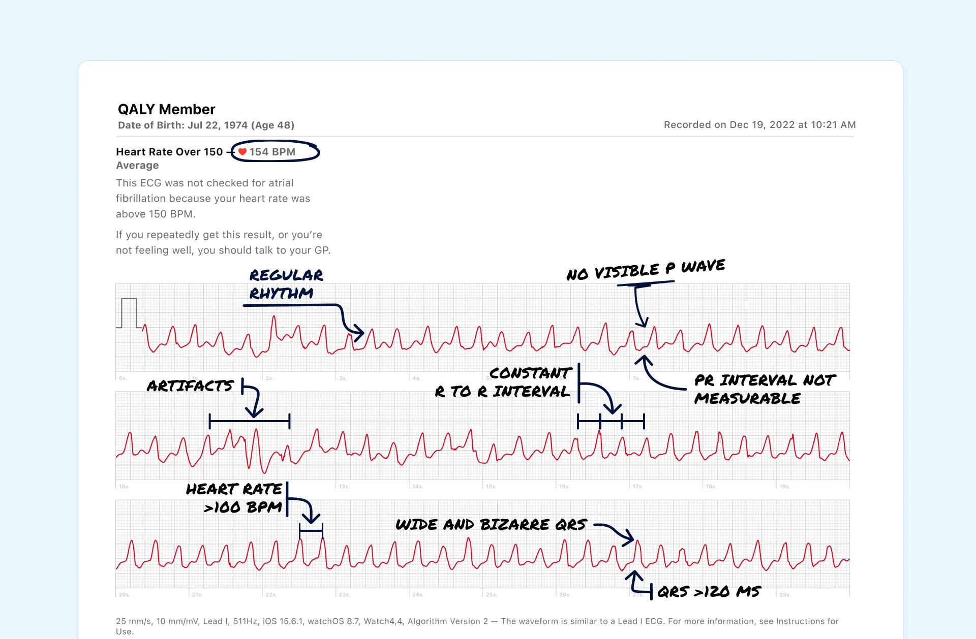 Supraventricular Tachycardia (Sustained) Vs. Ventricular Tachycardia ...