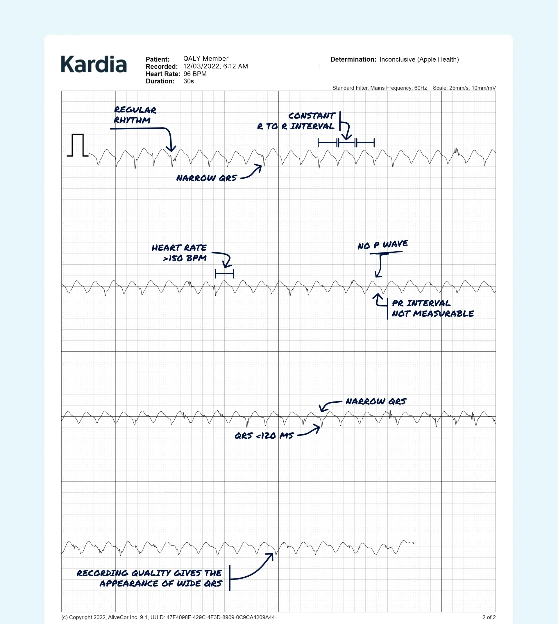 Supraventricular Tachycardia (Sustained) Vs. Ventricular Tachycardia ...
