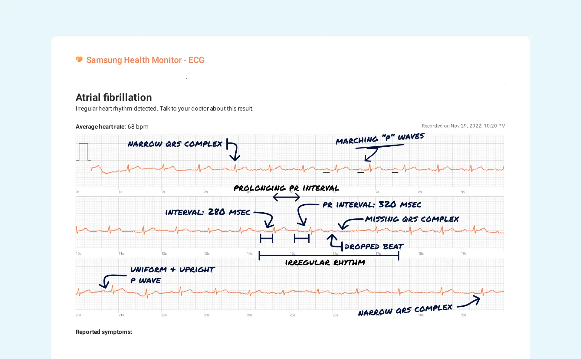 Sinus Rhythm Vs. First Degree AV Block on Your Watch ECG | Qaly