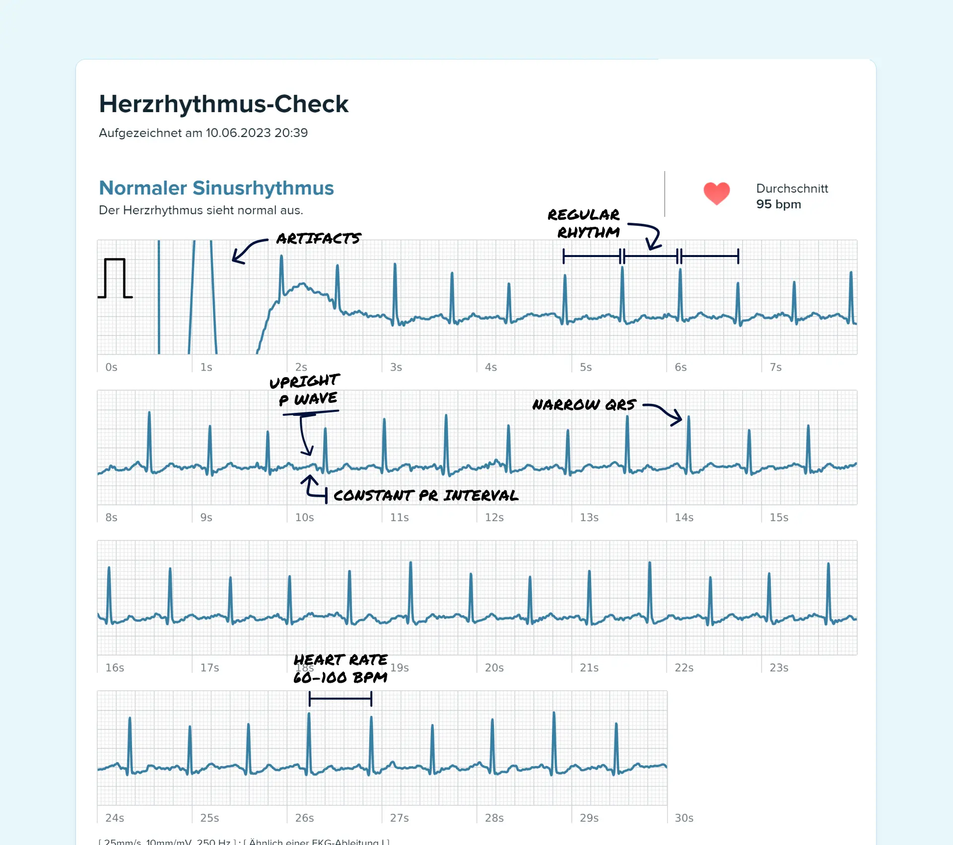 Sinus Rhythm Vs. Premature Ventricular Contraction (Multiple) on Your Watch ECG | Qaly