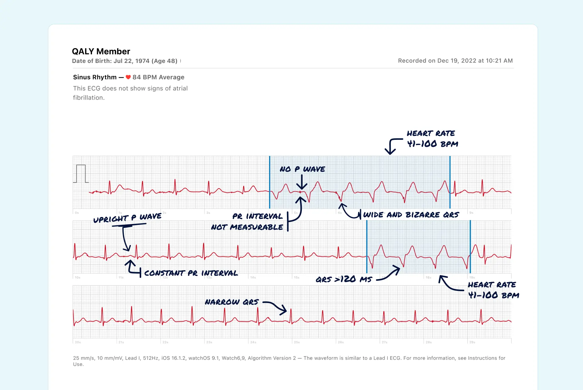 Ventricular Tachycardia (Non-Sustained) Vs. Accelerated Idioventricular ...