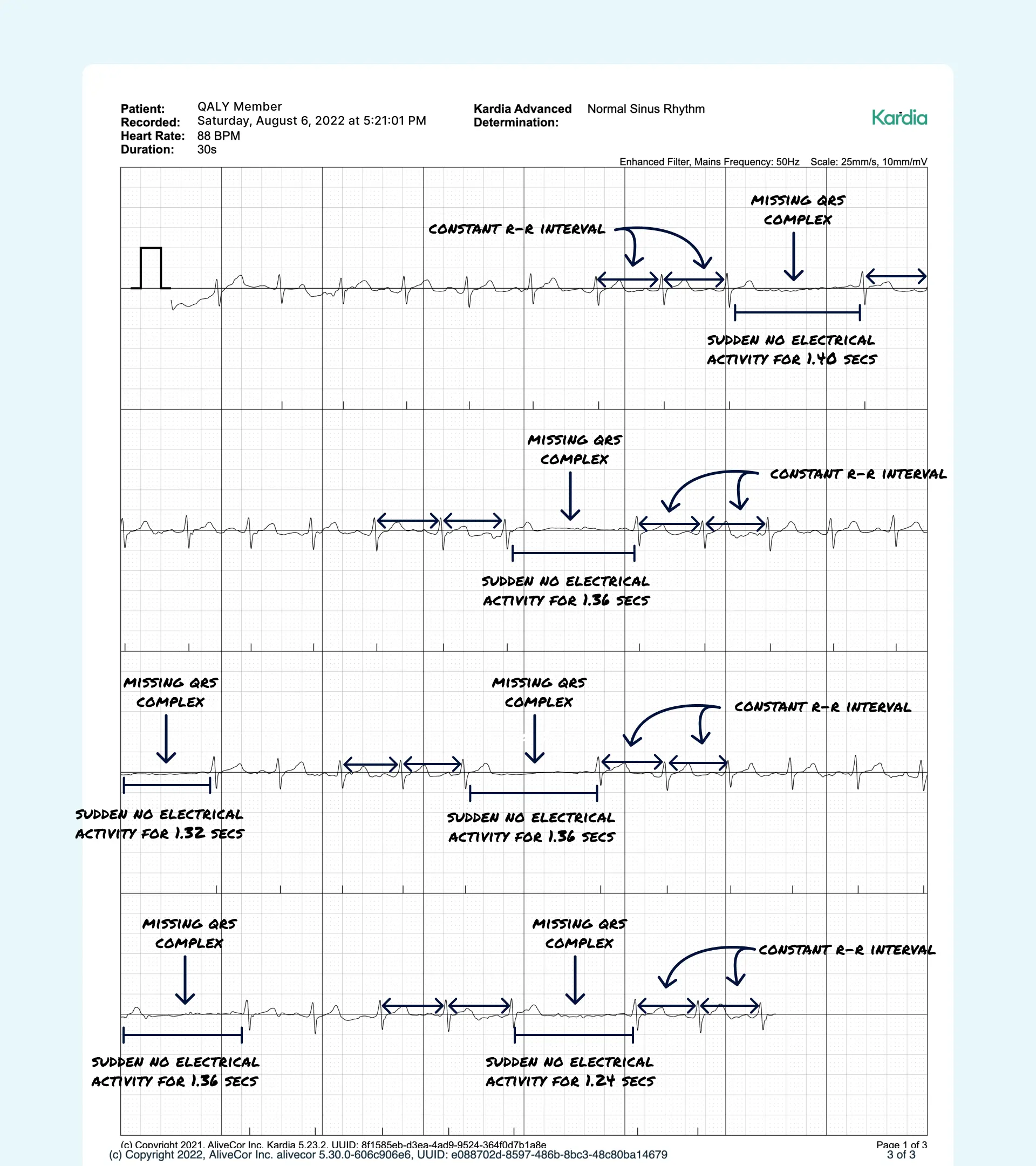 Sinus Arrhythmia Vs. Sinus Pause
