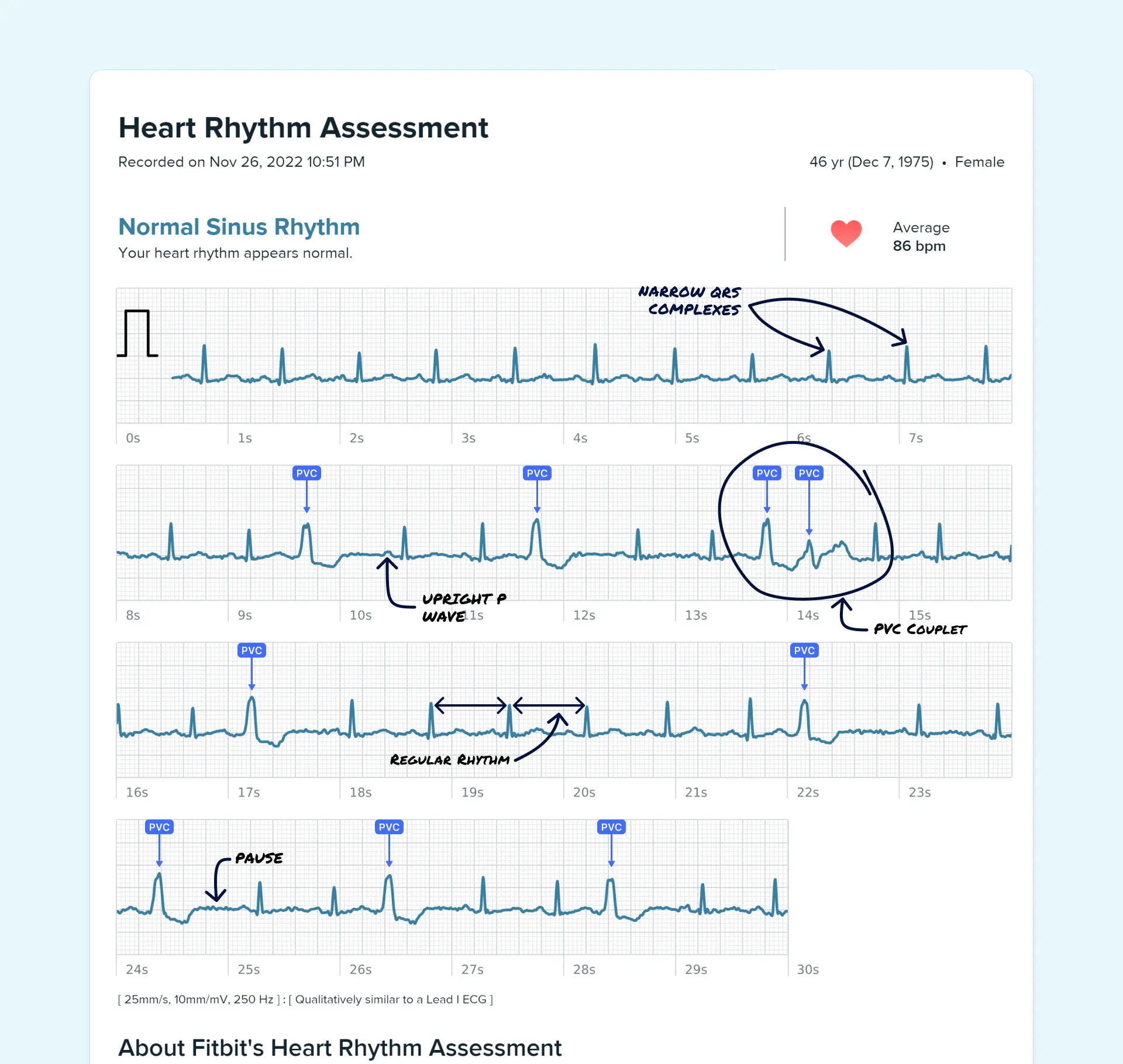 Premature Ventricular Contraction (Multiple) Vs. Ventricular Trigeminy ...