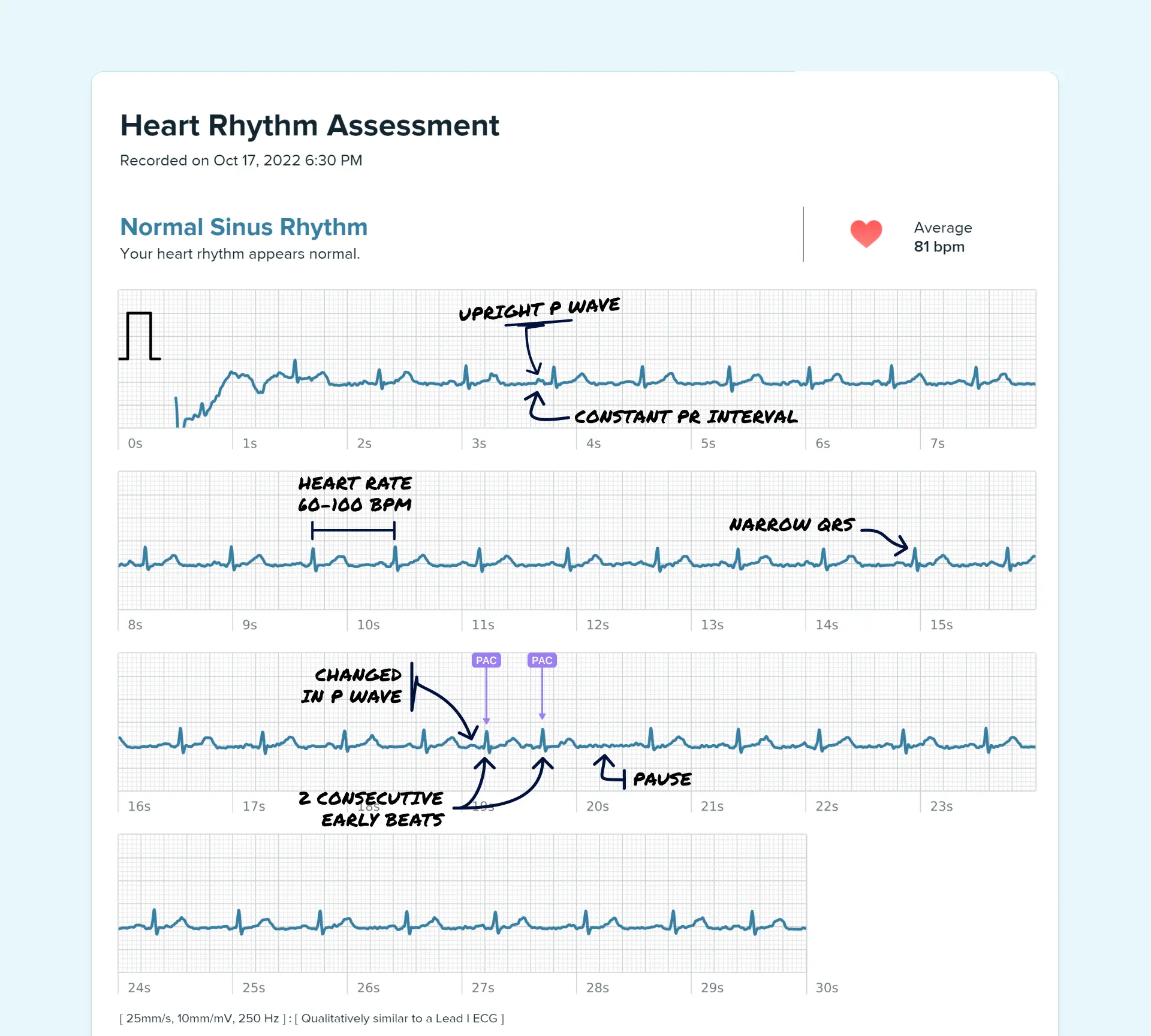 Premature Atrial Contraction (Multiple) Vs. Premature Atrial ...