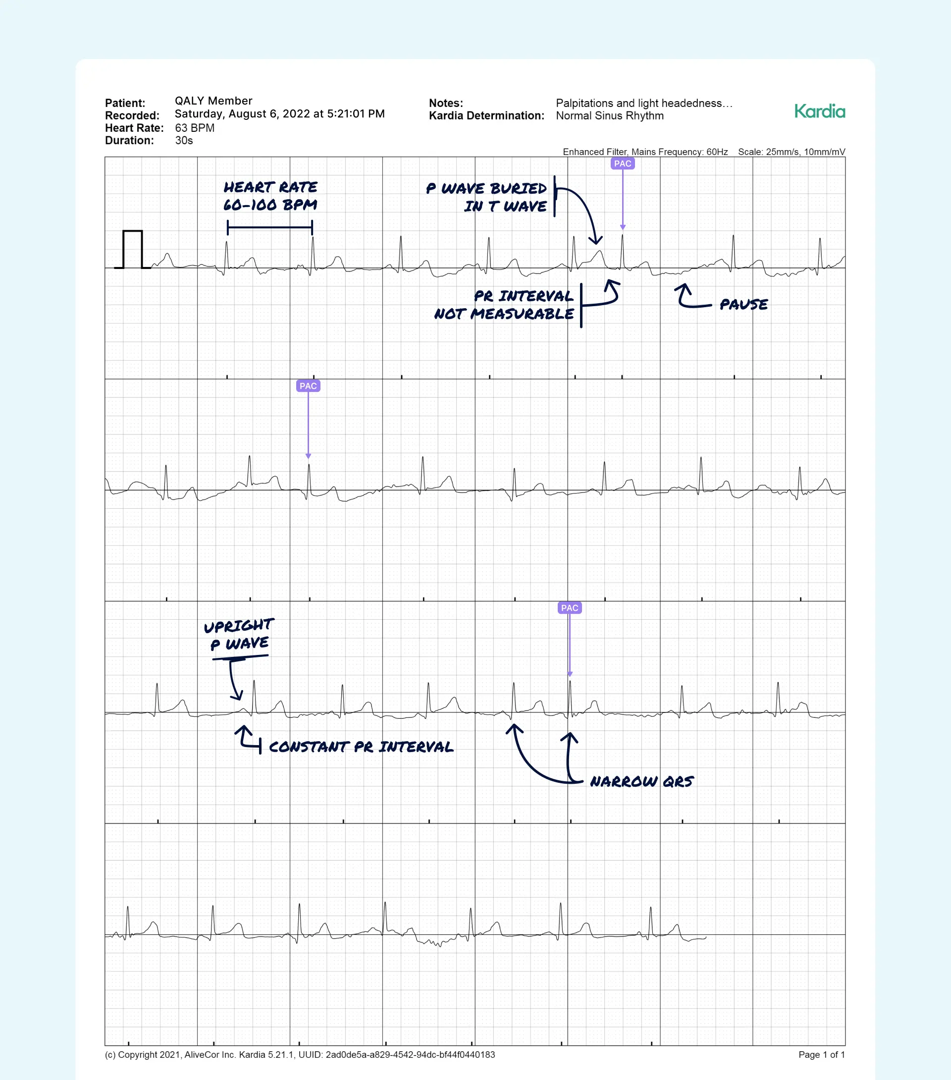 Premature Atrial Contraction (Multiple) Vs. Premature Atrial ...