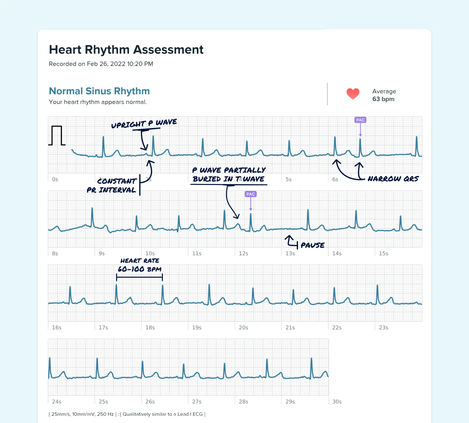 Premature Atrial Contraction (Multiple) Vs. Premature Atrial ...