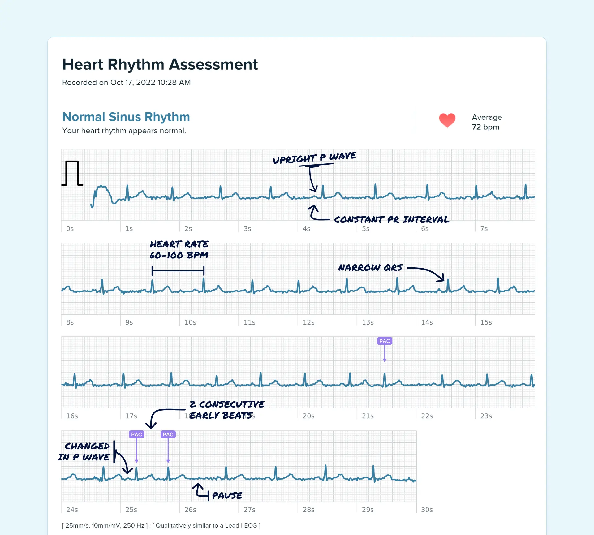 Premature Atrial Contraction (Multiple) Vs. Premature Atrial ...