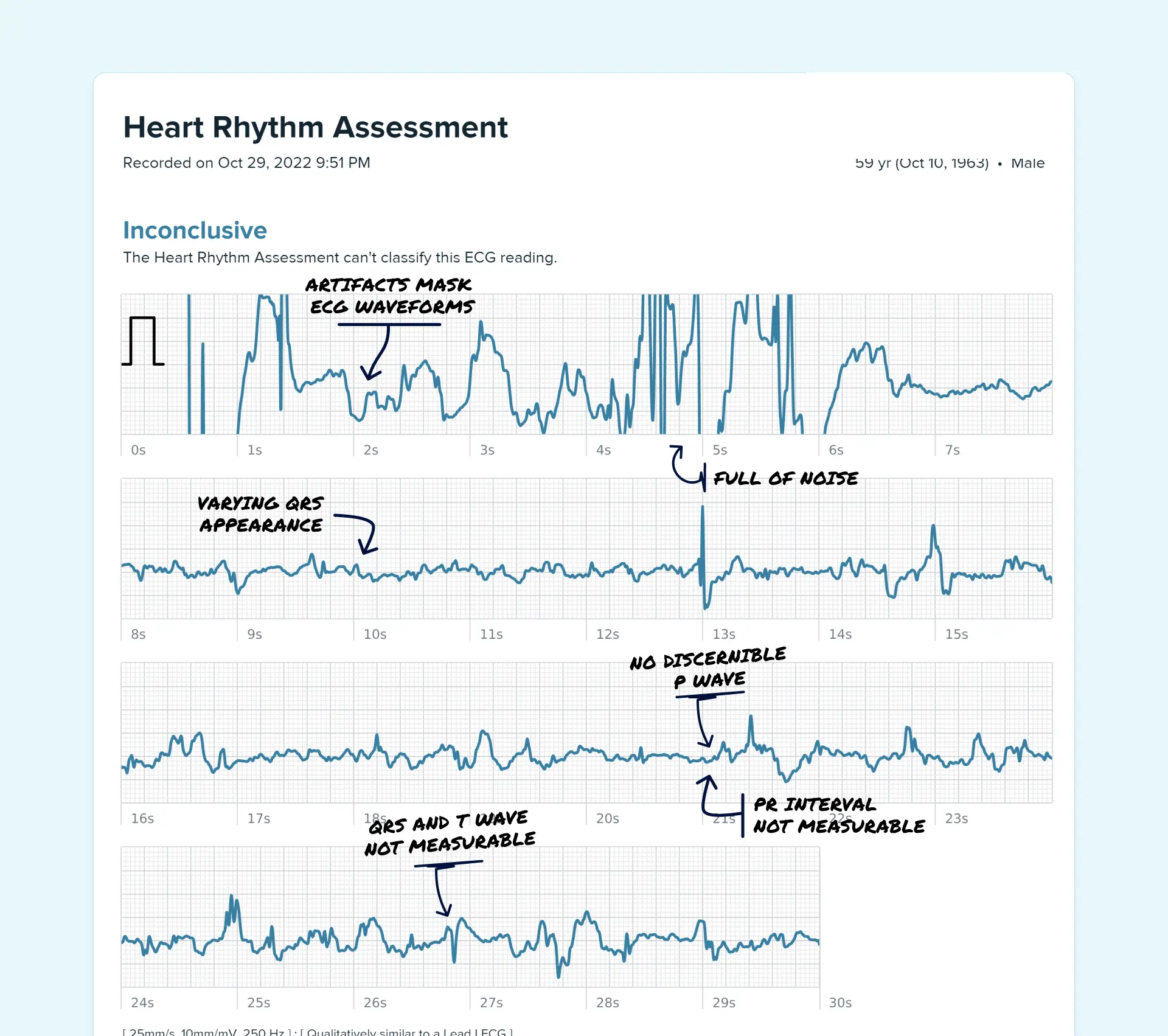 Unreadable / Noisy Vs. Ventricular Tachycardia (Sustained) on Your ...