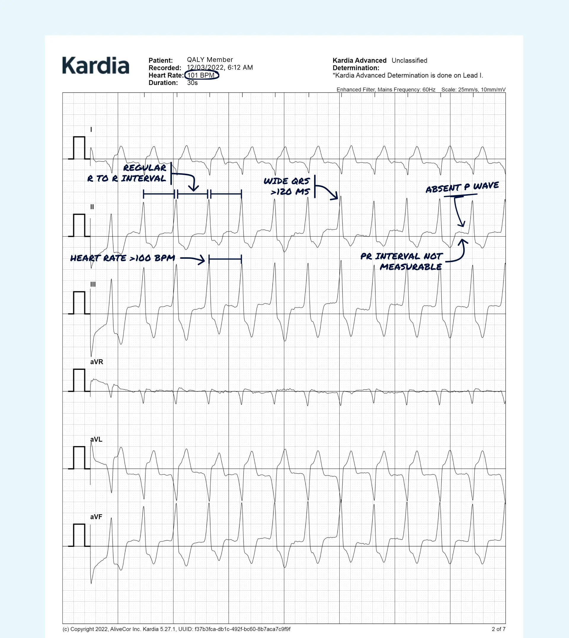Unreadable / Noisy Vs. Ventricular Tachycardia (Sustained) on Your ...