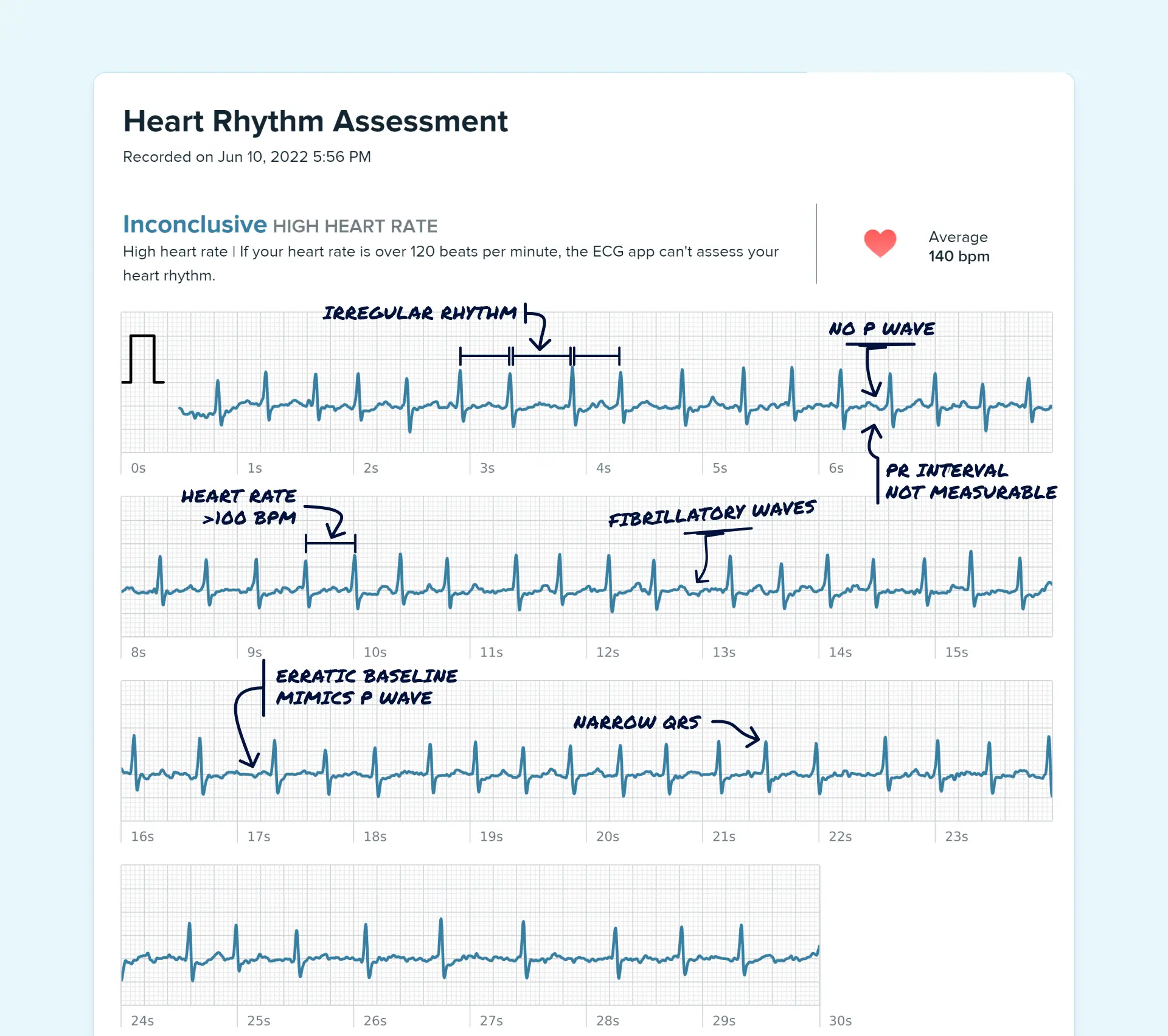 Ectopic Atrial Rhythm Vs. Atrial Fibrillation on Your Watch ECG | Qaly