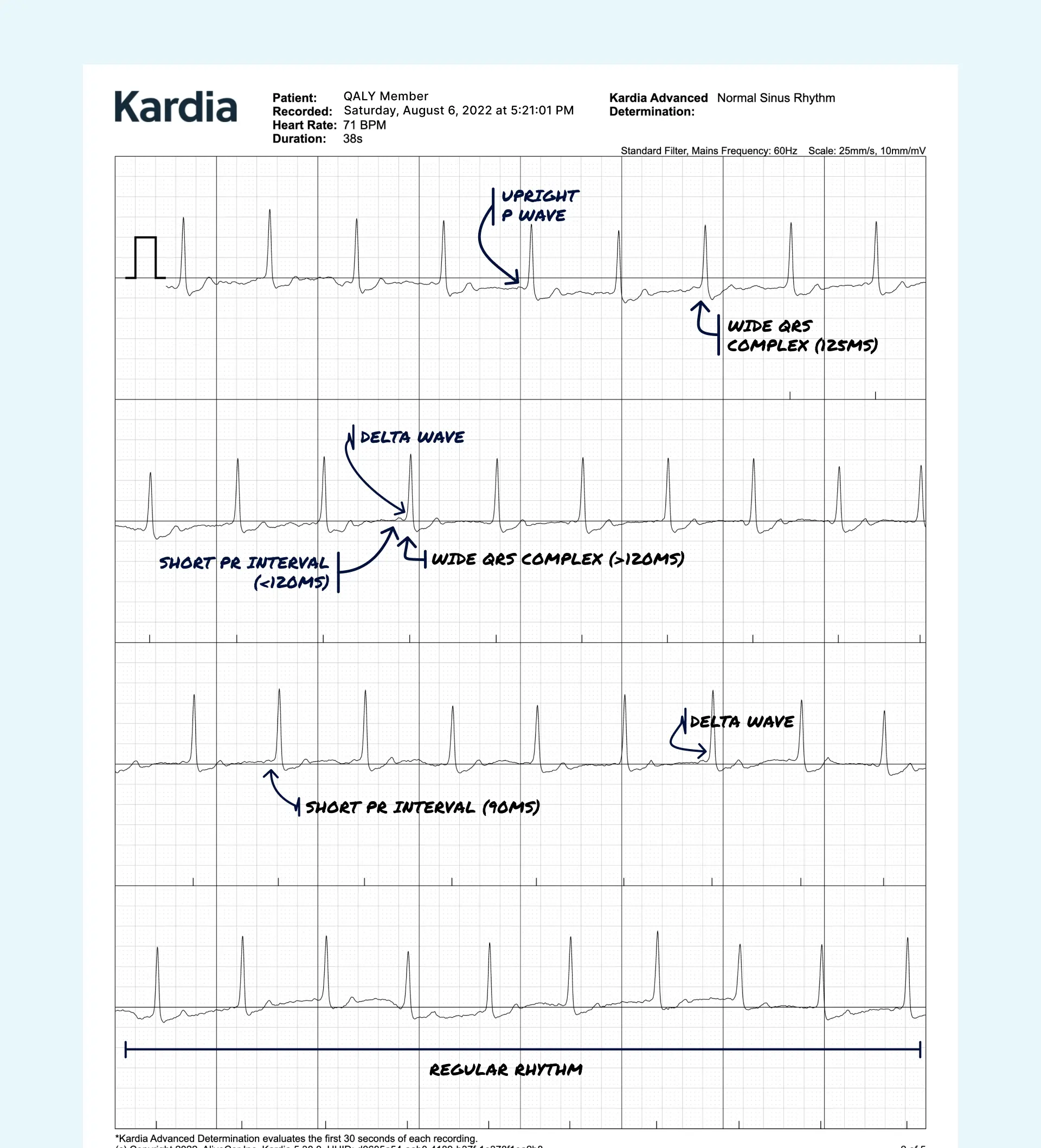 Sinus Rhythm Vs. Wolff-Parkinson-White Syndrome on Your Watch ECG | Qaly