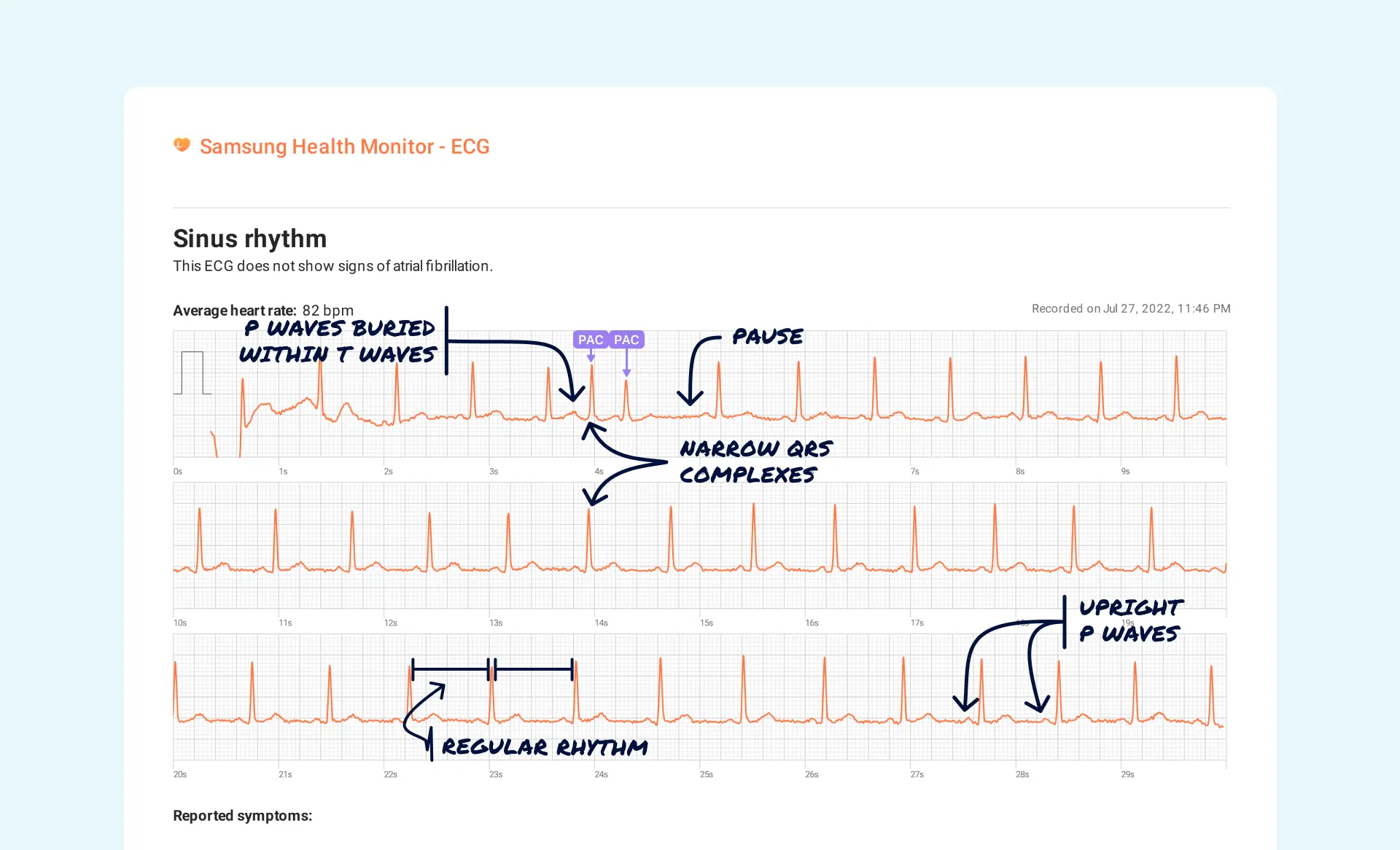 Ectopic Atrial Rhythm Vs. Premature Atrial Contraction (Couplet) on ...