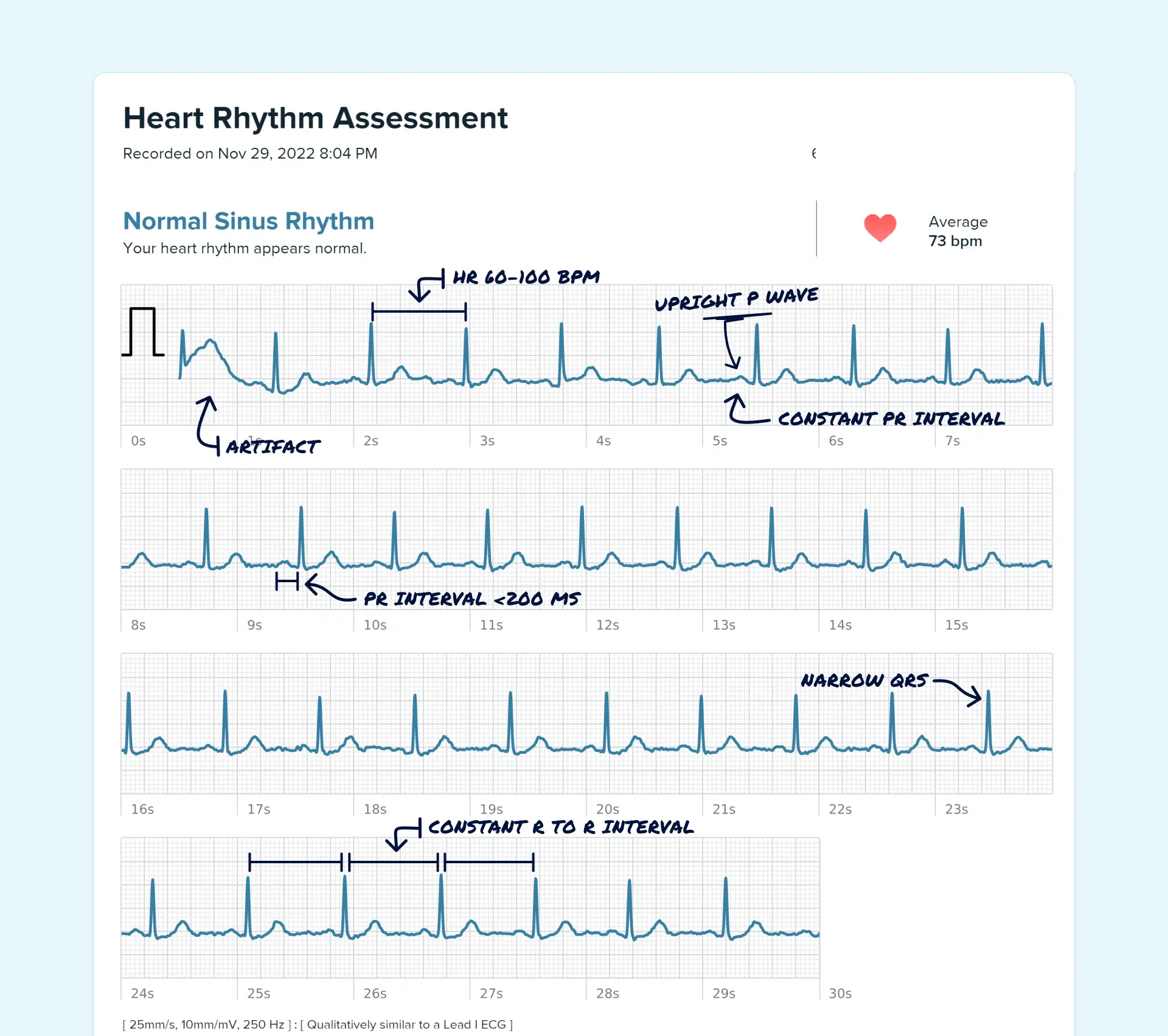 Sinus Rhythm Vs. Ectopic Atrial Rhythm on Your Watch ECG | Qaly