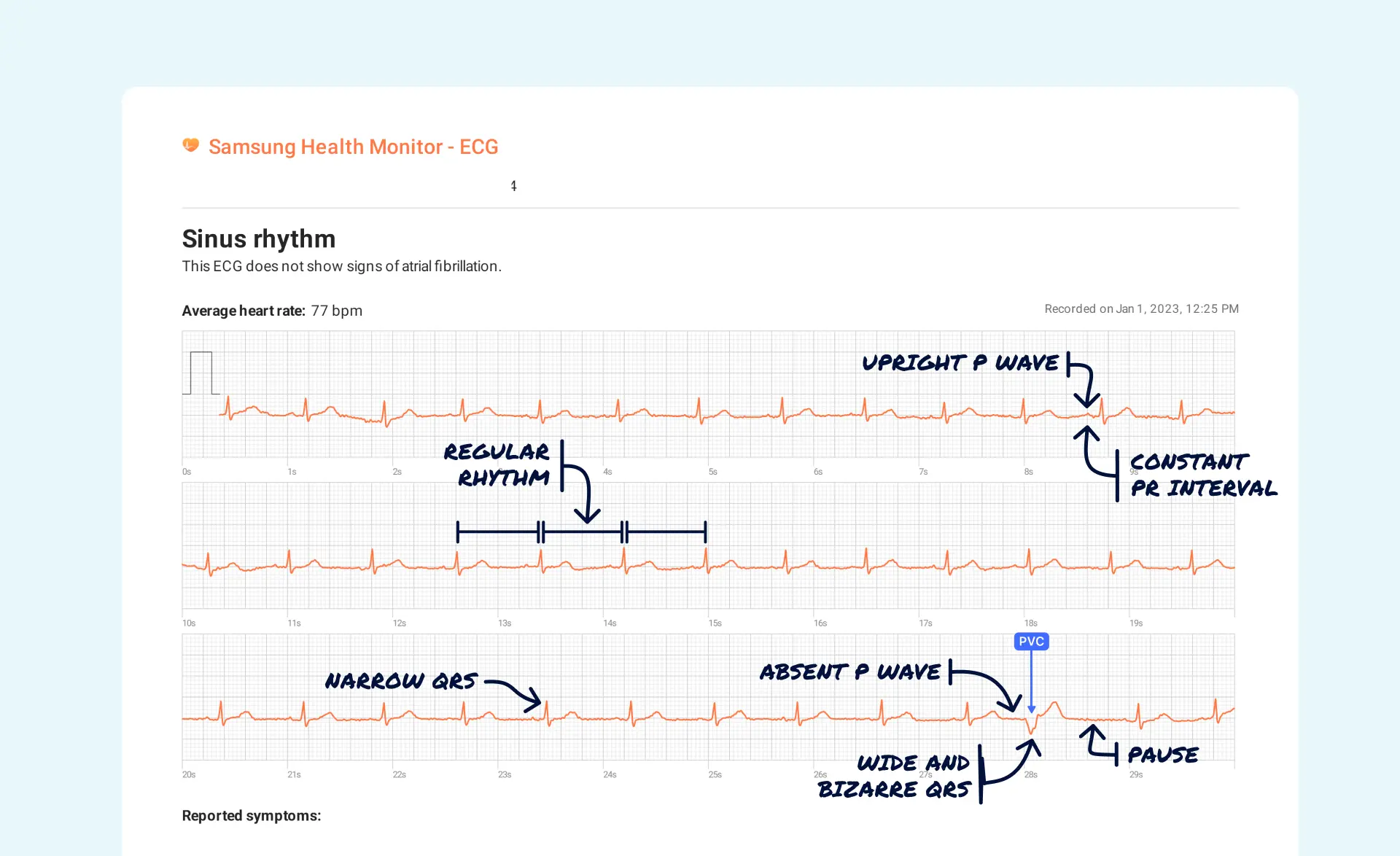 Premature Ventricular Contraction (Single) Vs. Premature Ventricular ...