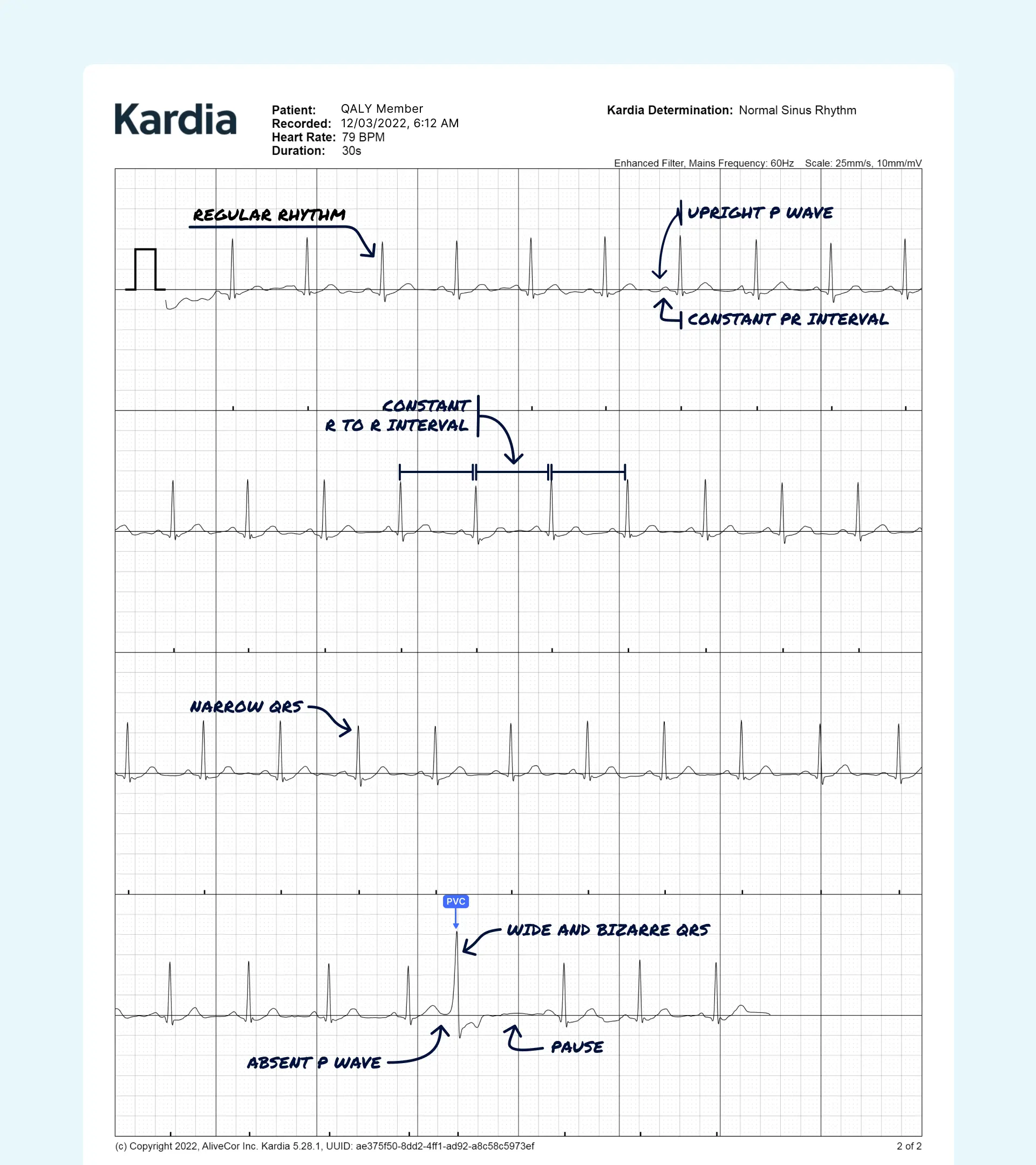 Premature Ventricular Contraction (Single) Vs. Premature Ventricular Contraction (Multiple) on ...