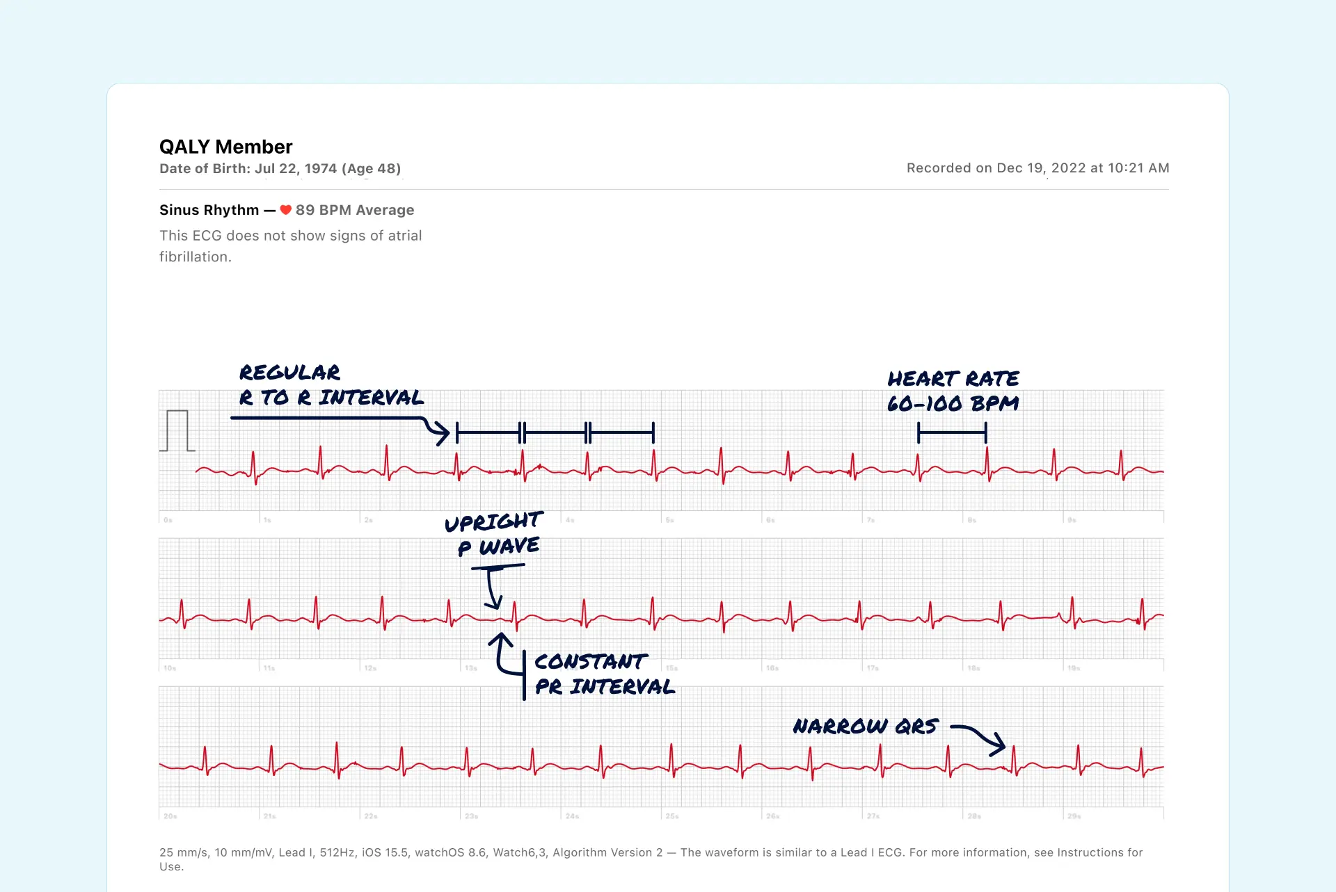 Sinus Rhythm Vs. Ectopic Atrial Rhythm on Your Watch ECG | Qaly