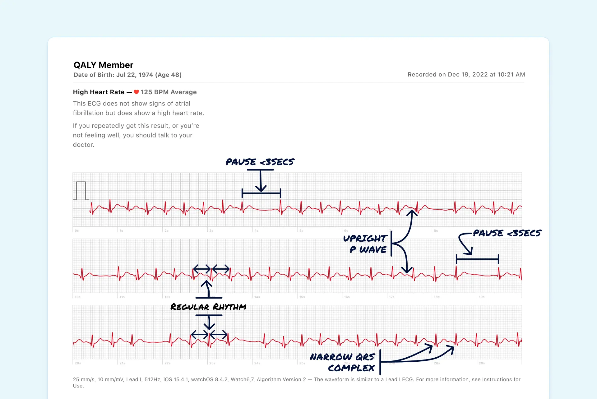 Premature Atrial Contraction (Single) Vs. Sinus Pause