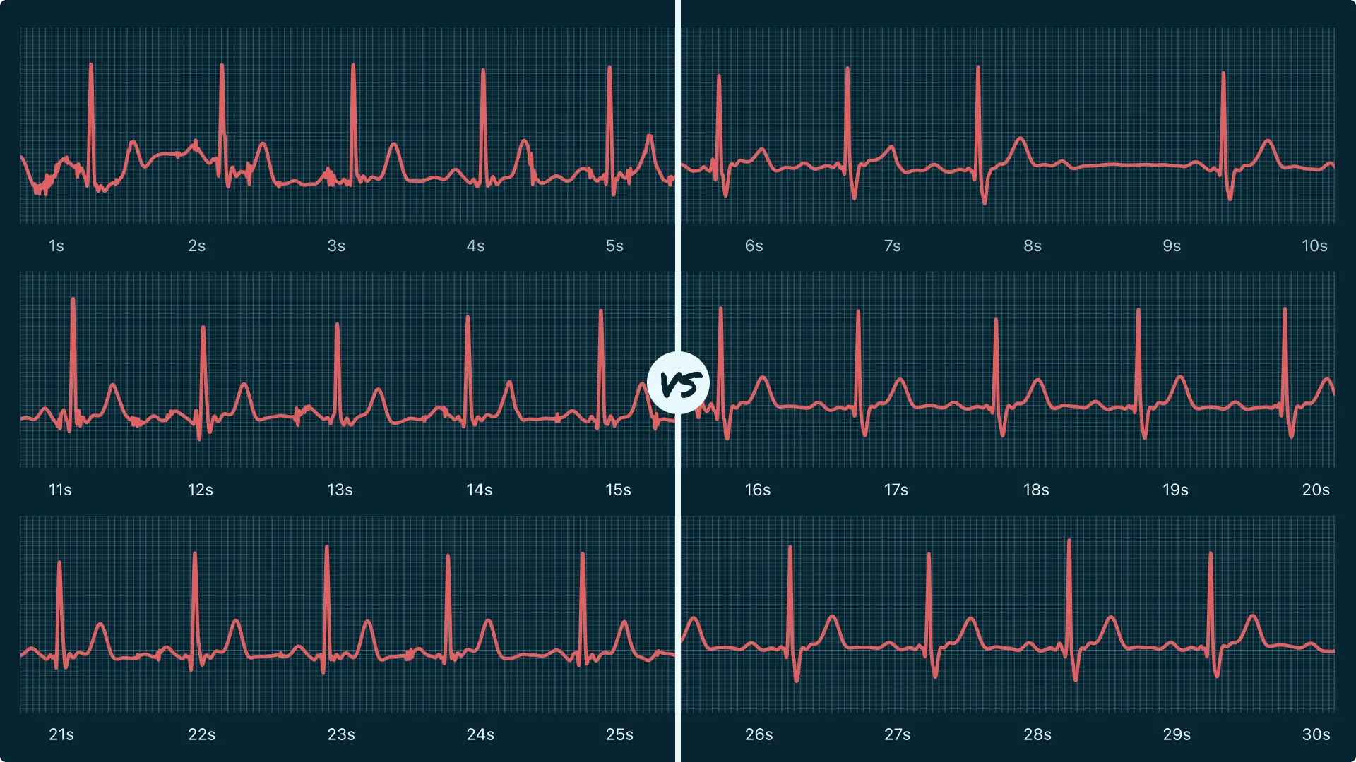 First Degree AV Block Vs. Wenckebach on Your Watch ECG | Qaly